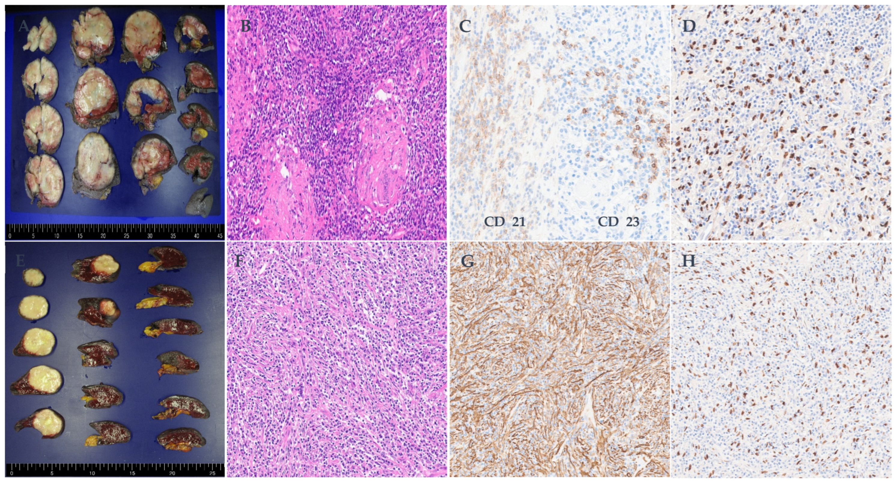 Clinicopathological Spectrum of EBV-Related Primary Splenic Tumors ...