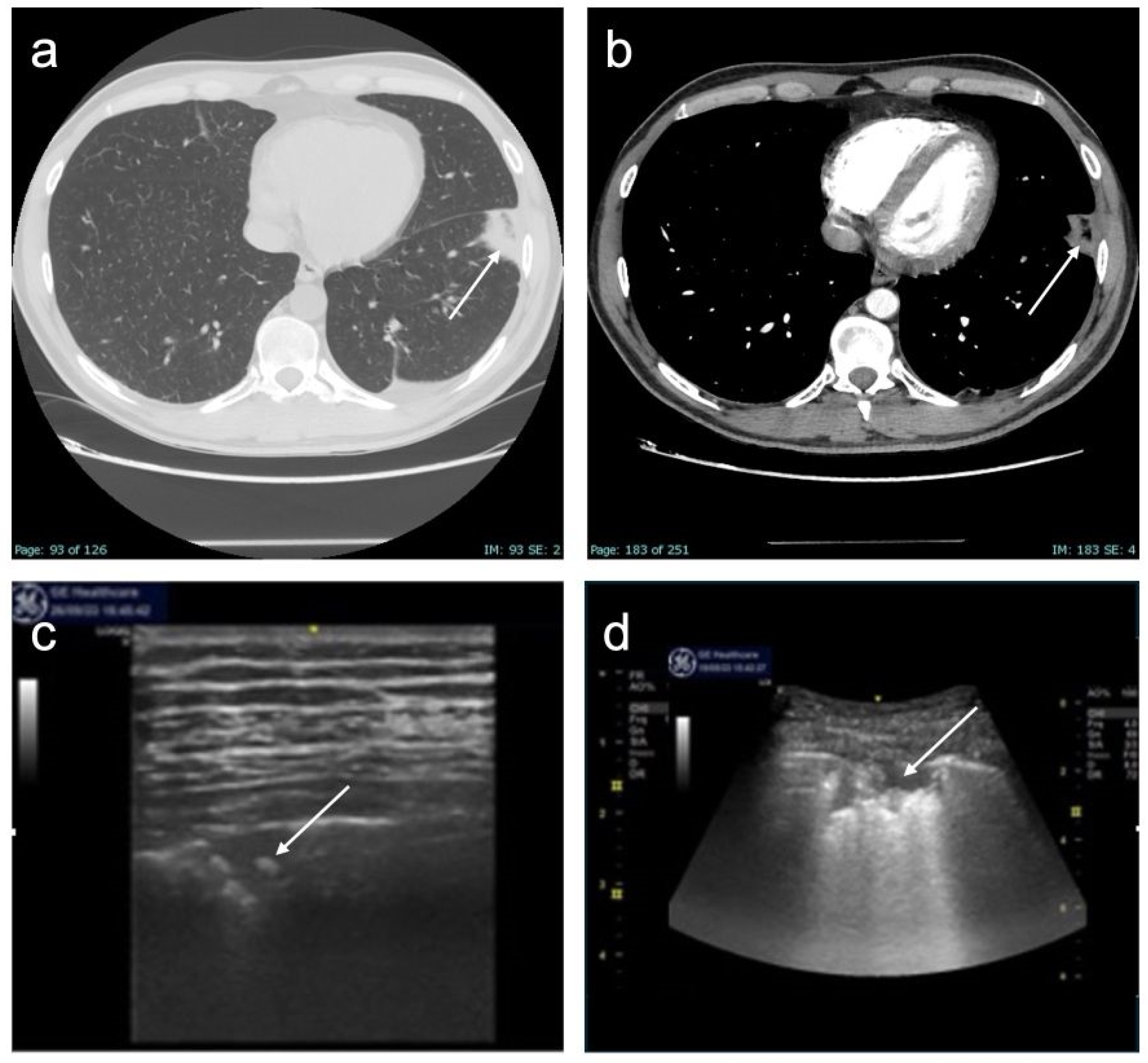 Morphological Analysis and Short-Term Evolution in Pulmonary Infarction ...