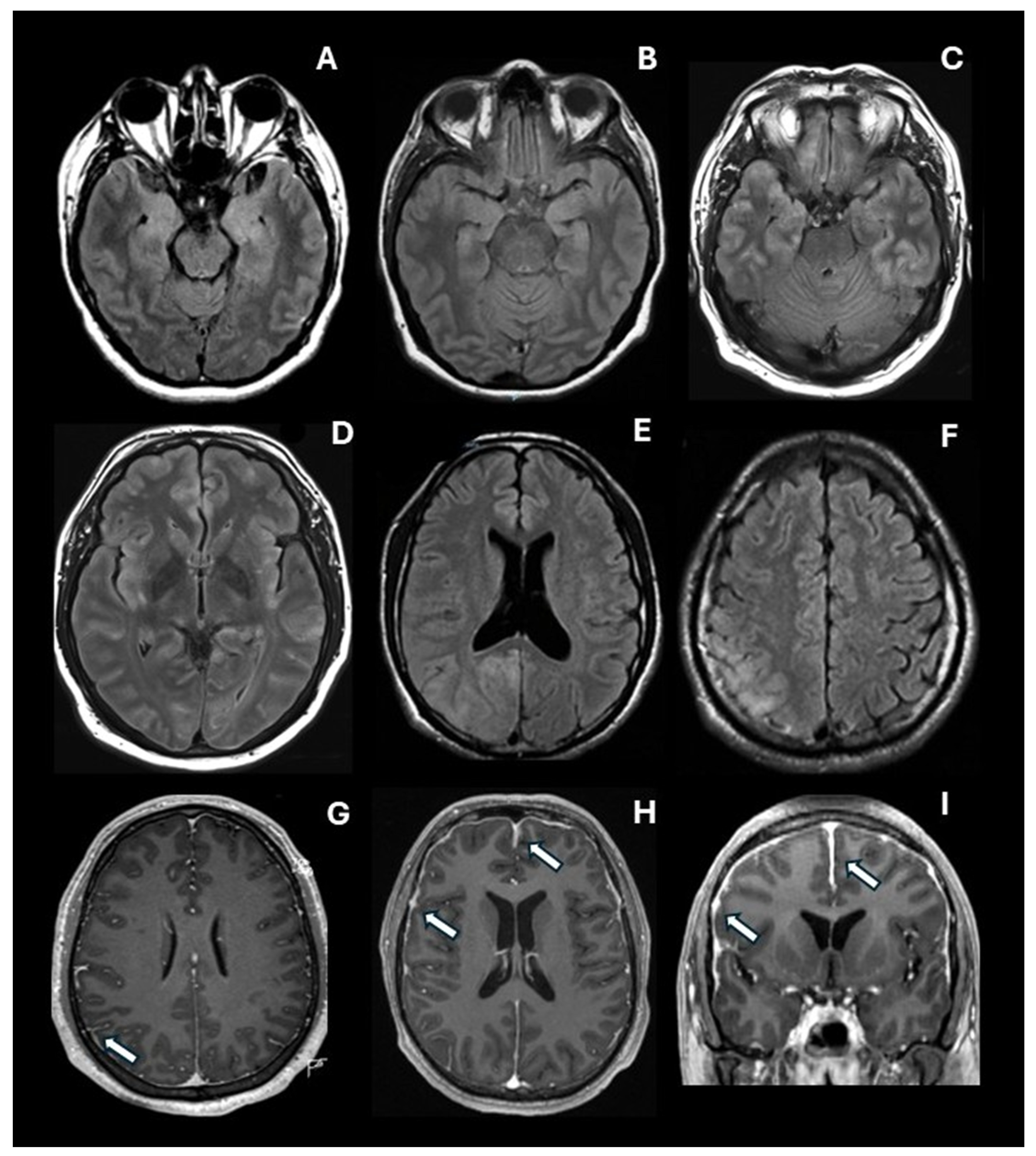 Abnormal Magnetic Resonance Imaging Patterns in Patients with ...