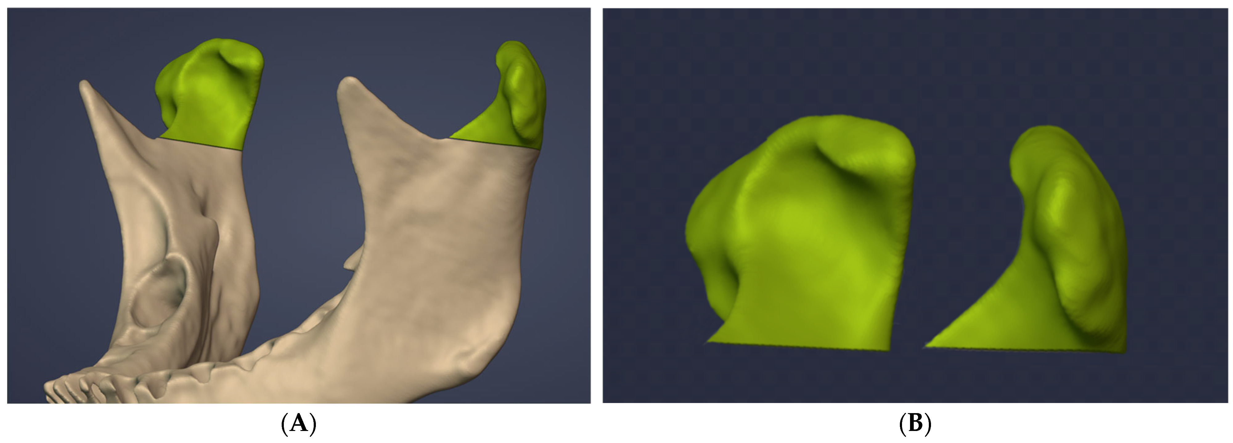 Three-Dimensional Evaluation of TMJ Morphology in Individuals with ...