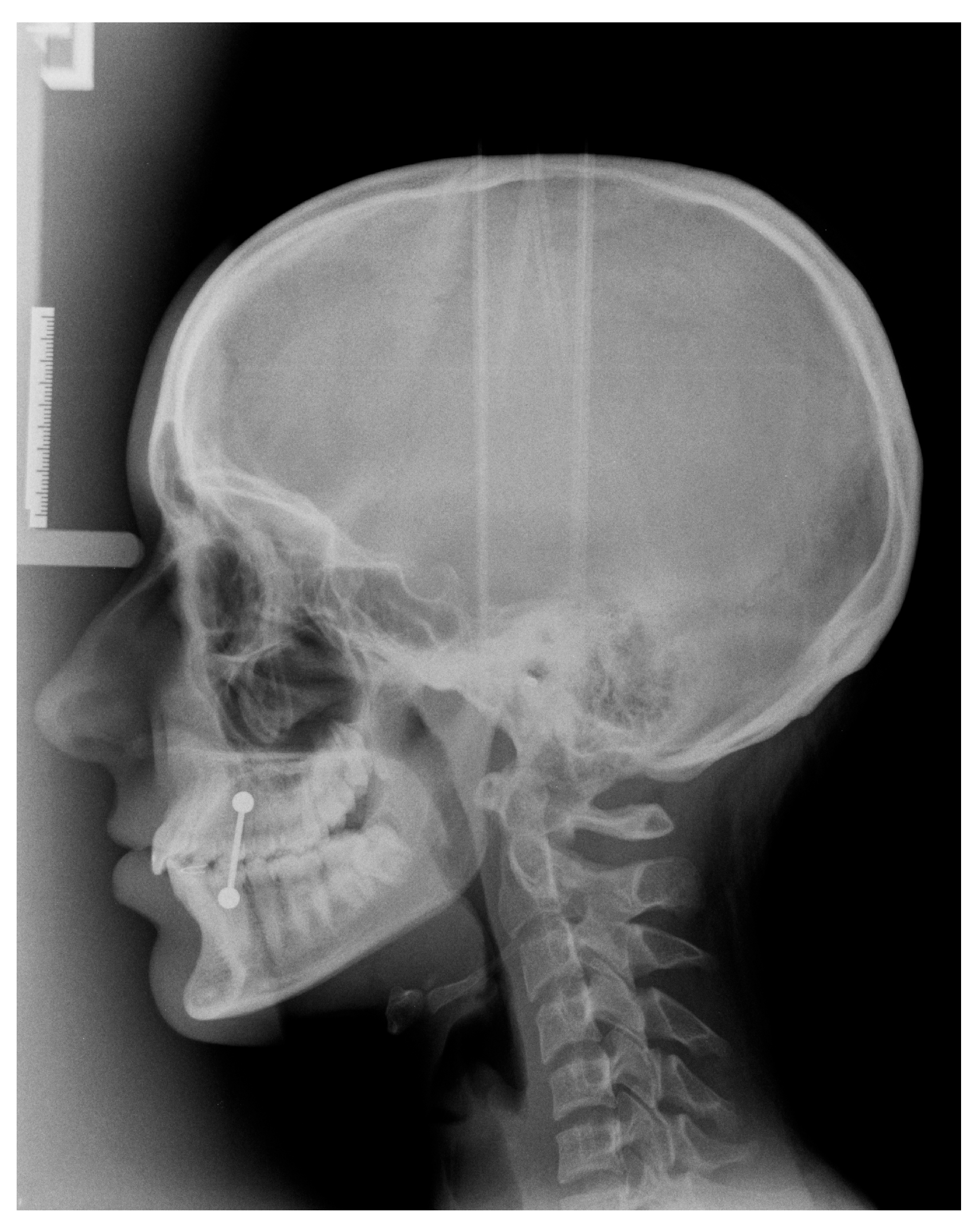 Lateral Cephalometric Radiography: Principles, Common Positioning ...