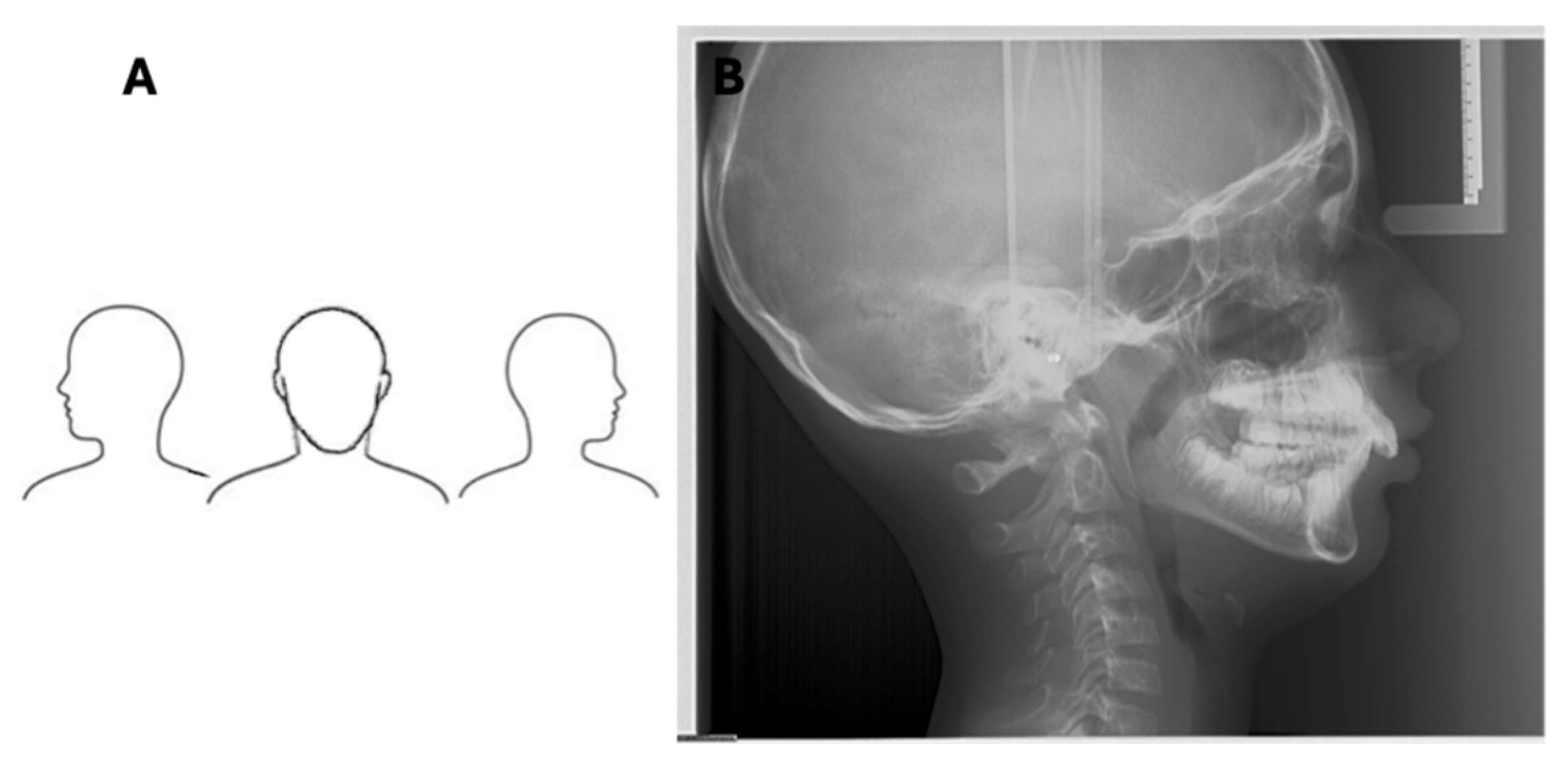 Lateral Cephalometric Radiography: Principles, Common Positioning ...