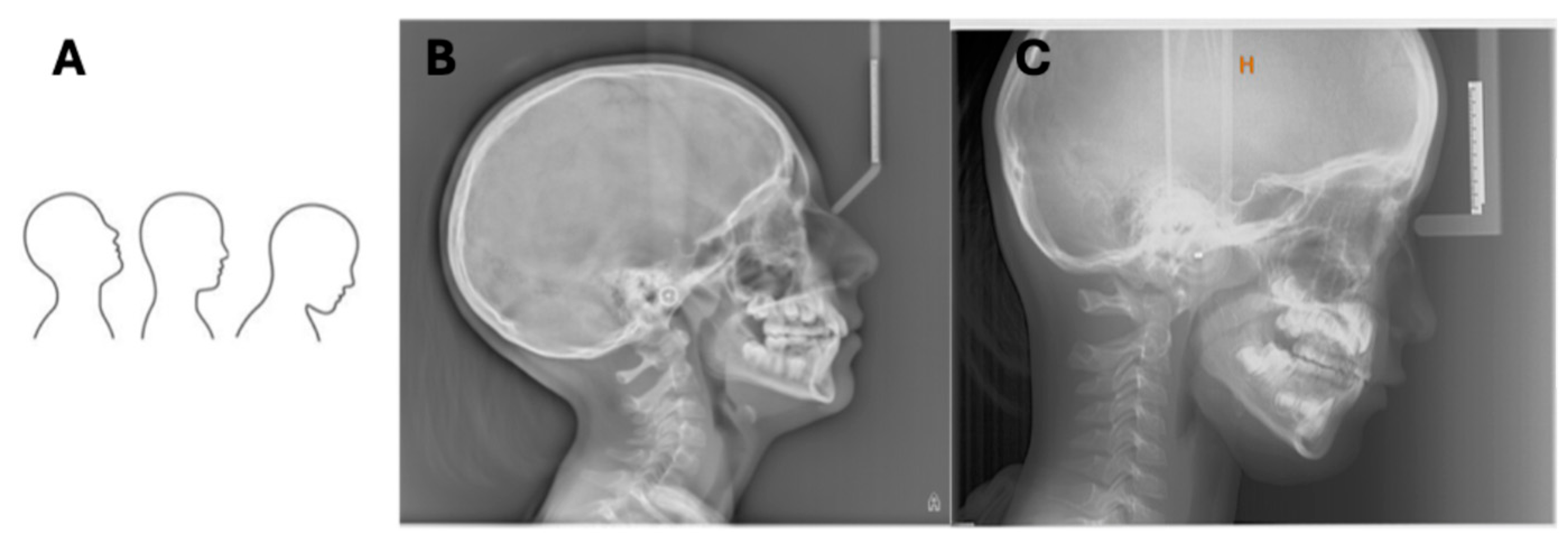 Lateral Cephalometric Radiography: Principles, Common Positioning ...