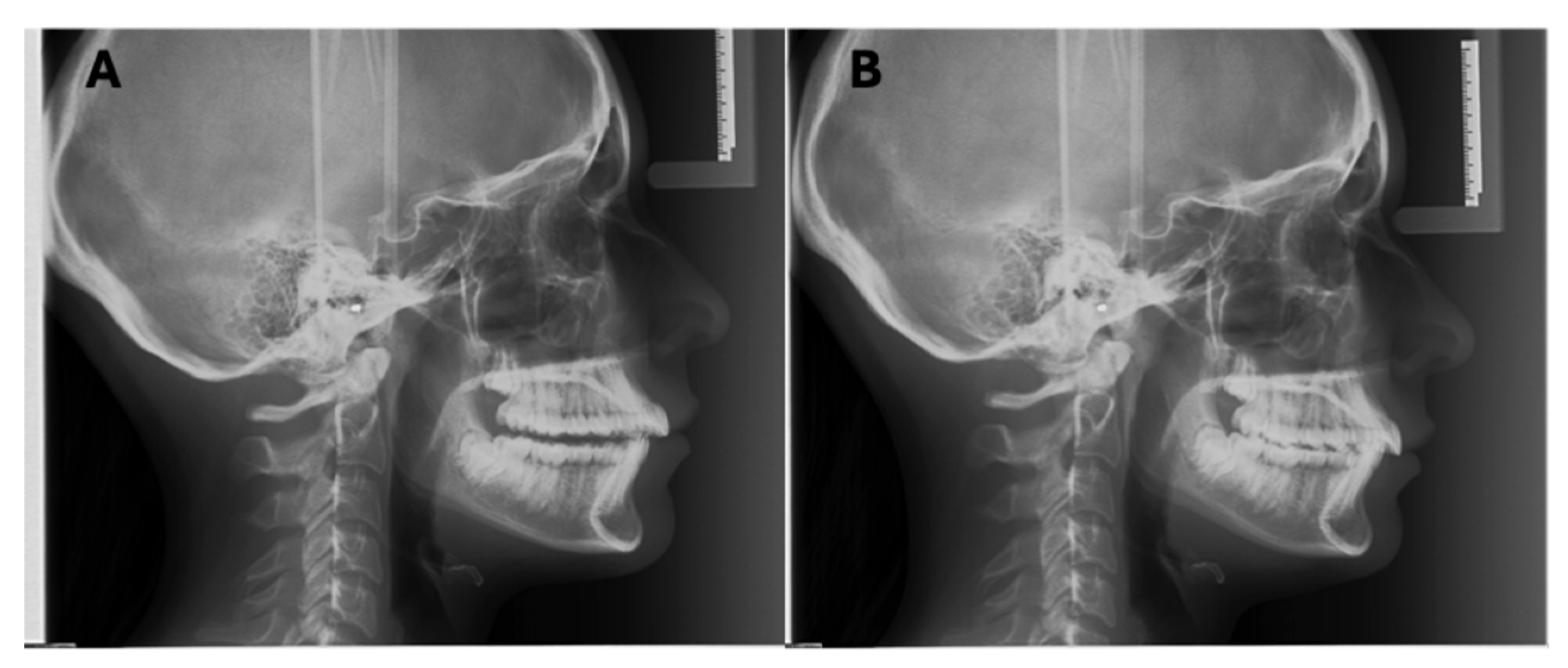 Lateral Cephalometric Radiography: Principles, Common Positioning ...