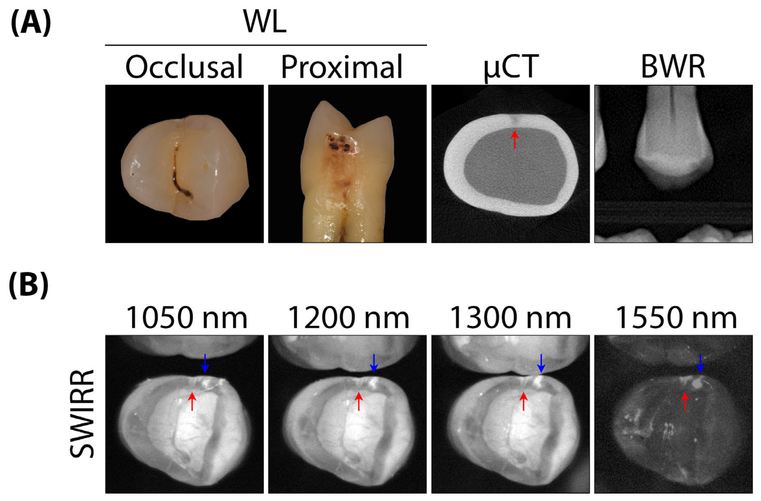Short-Wave Infrared Reflectance at 1050–1550 nm for Proximal Caries ...