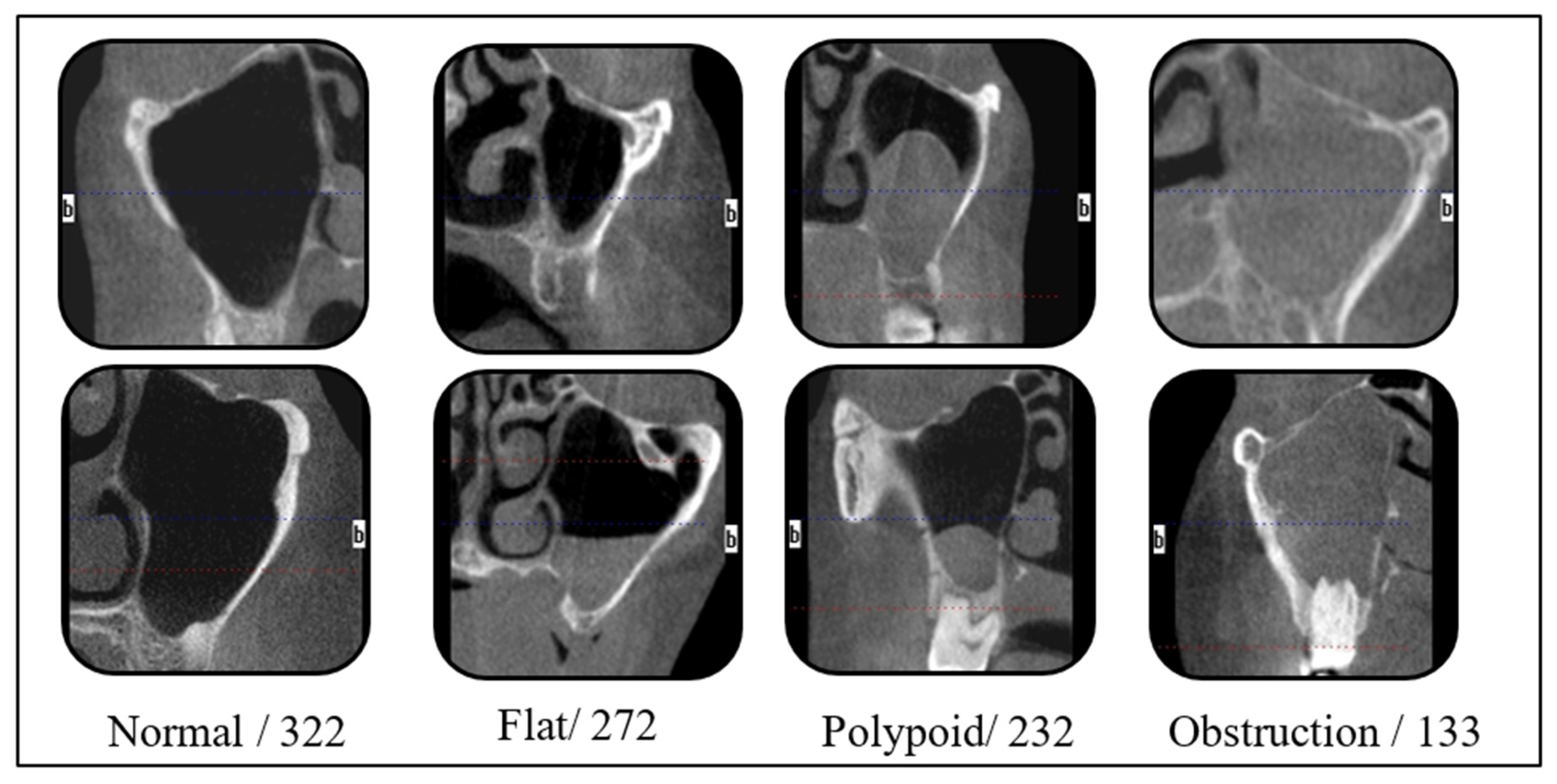 Evaluation of Maxillary Sinus Membrane Morphology Using a Novel Hybrid ...
