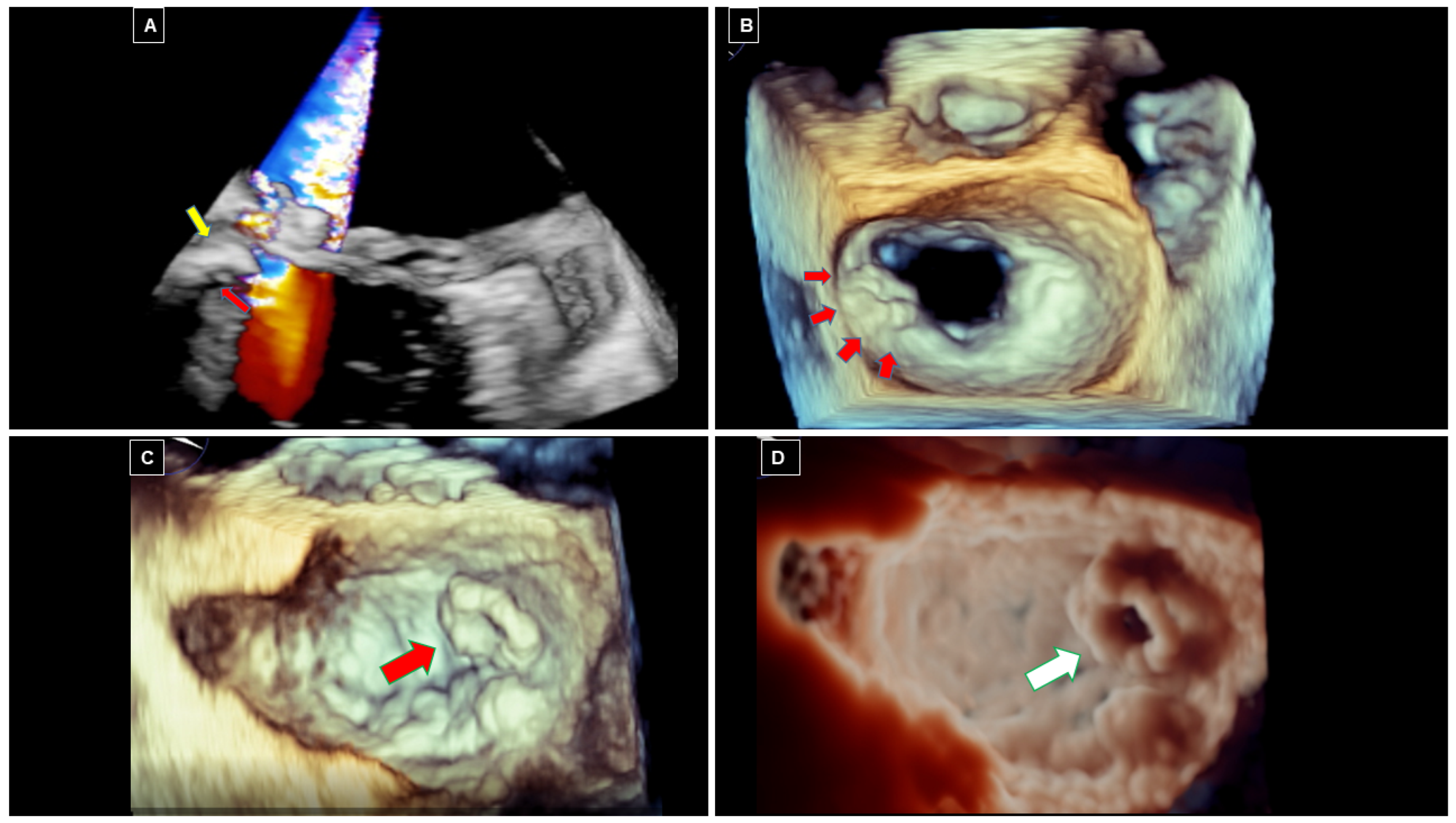 Rupture of Caseous Calcification of the Mitral Annulus: Pathophysiology ...