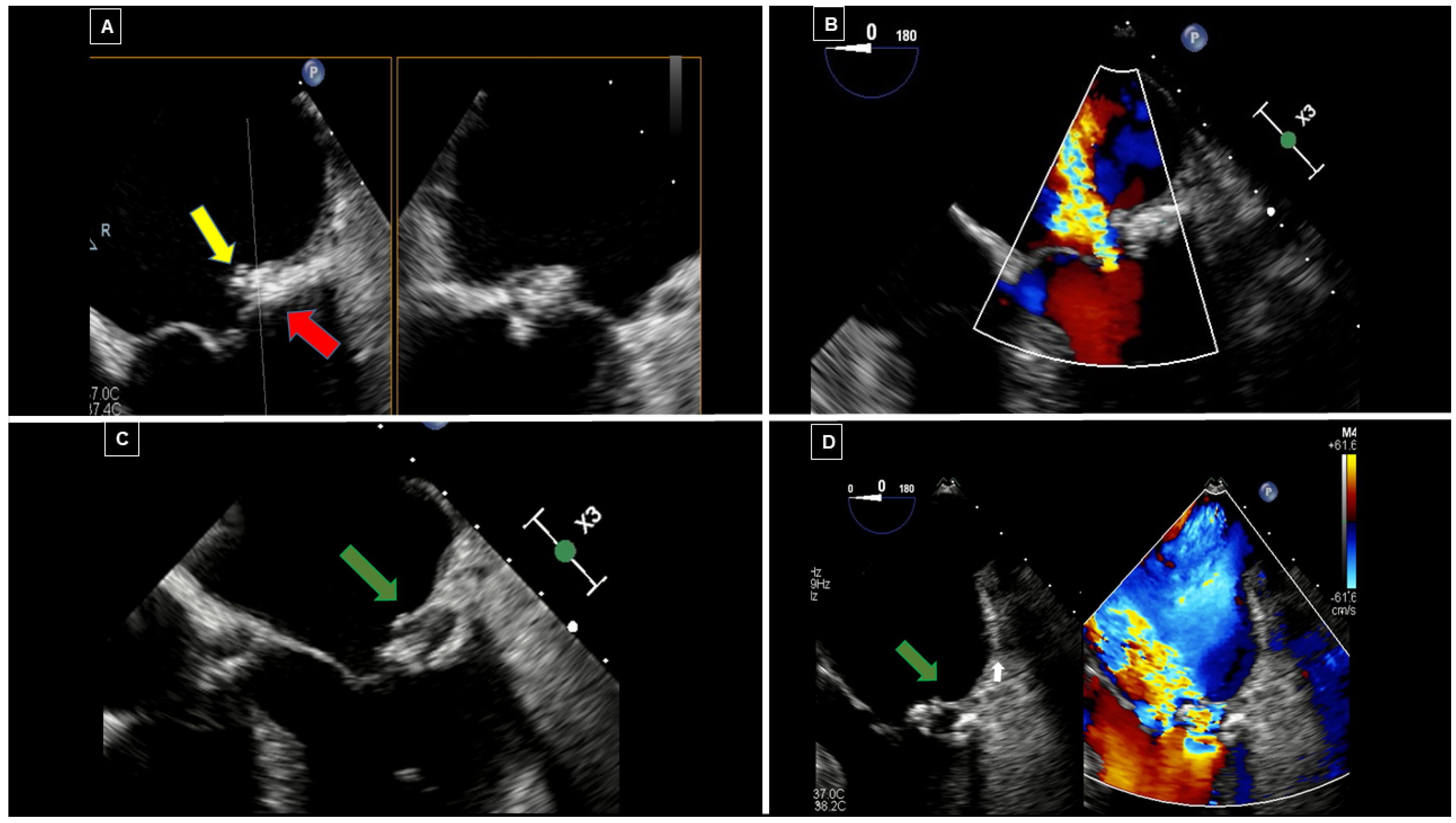 Rupture of Caseous Calcification of the Mitral Annulus: Pathophysiology ...