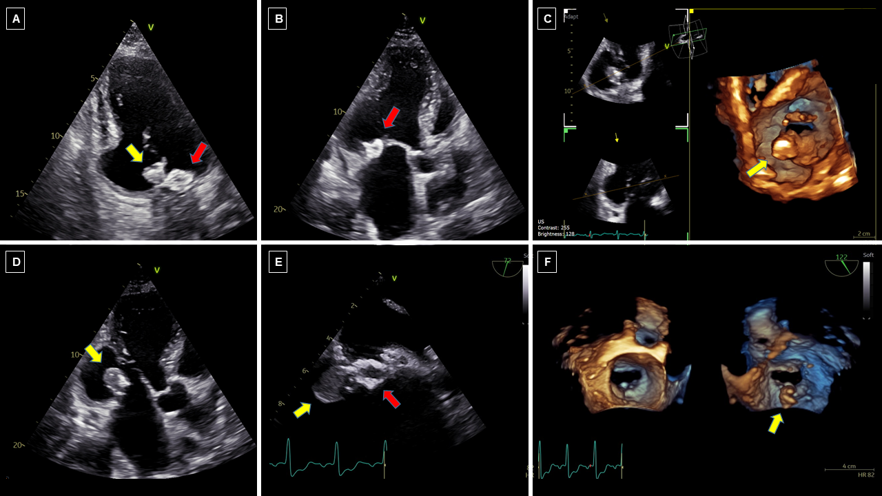 Rupture of Caseous Calcification of the Mitral Annulus: Pathophysiology ...