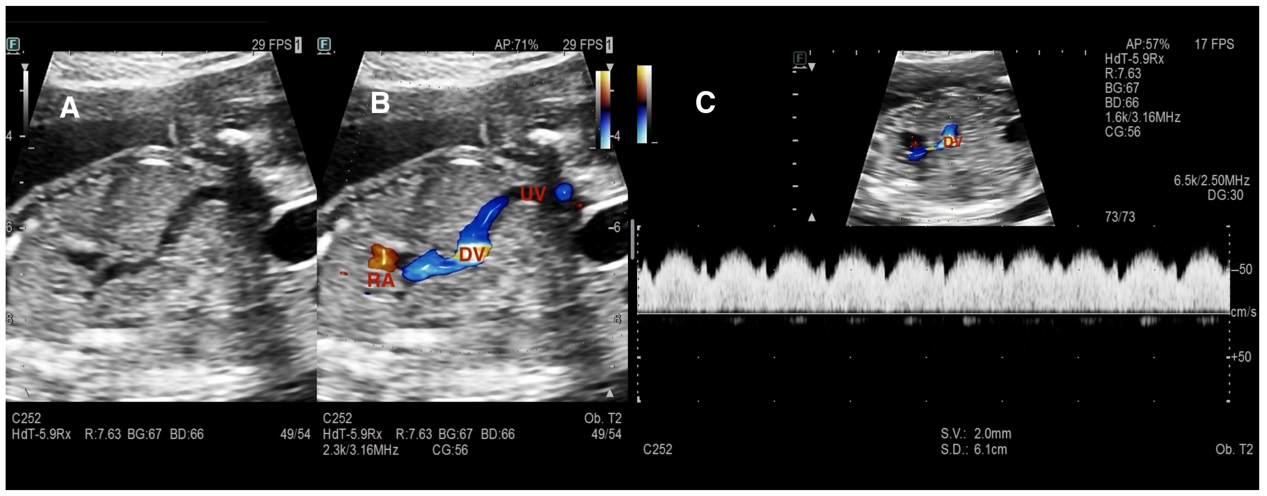 Prenatal Classification and Perinatal Outcomes of Fetal Umbilical ...