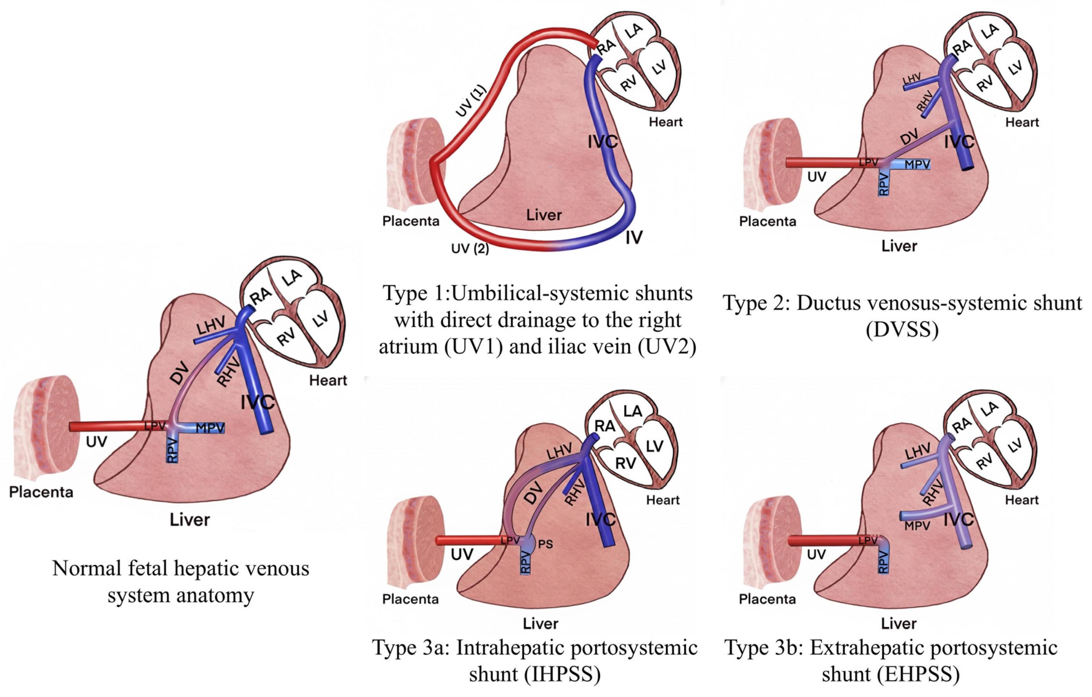 Prenatal Classification and Perinatal Outcomes of Fetal Umbilical ...
