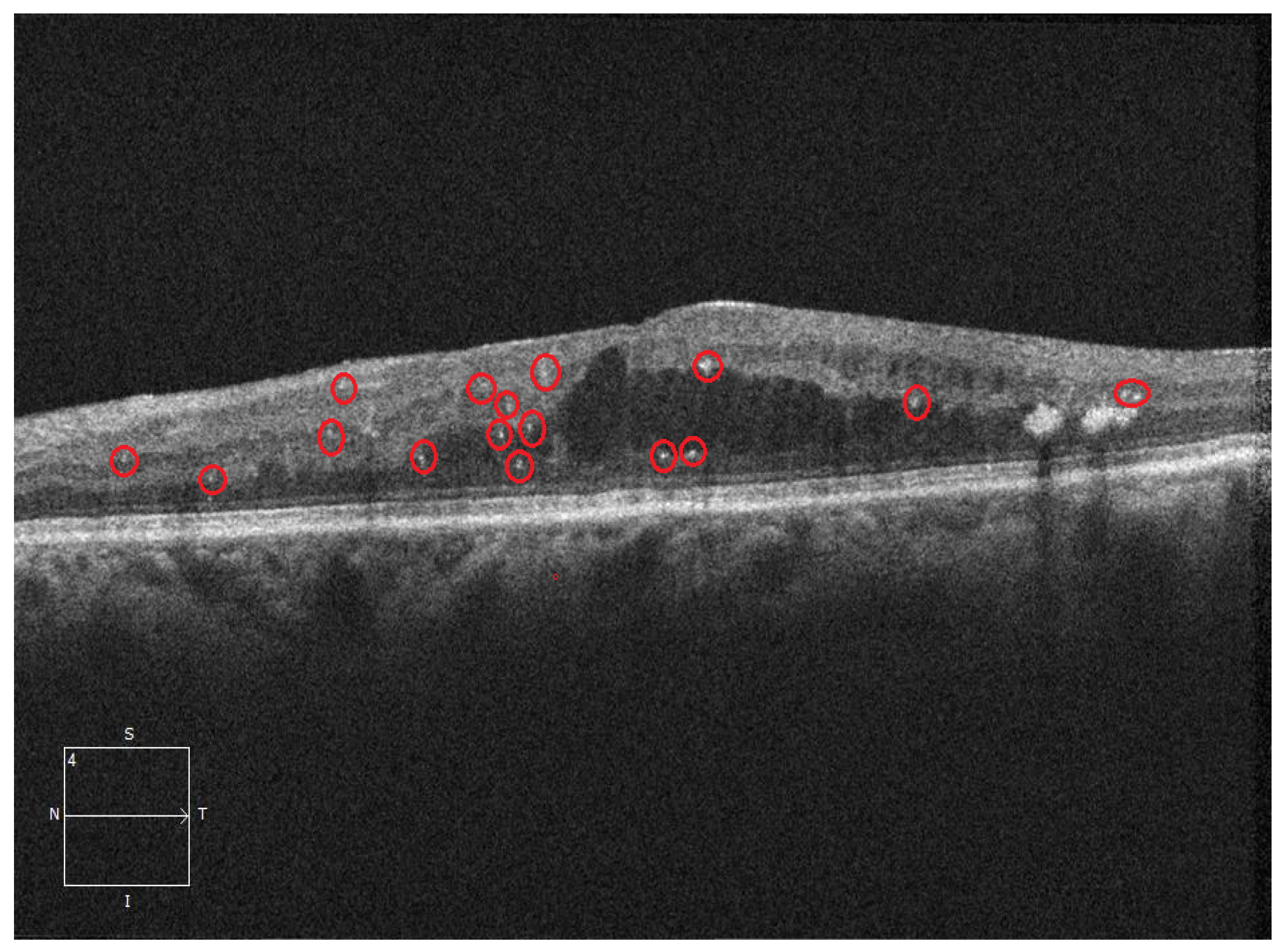 U-Net Optimization for Hyperreflective Foci Segmentation in Retinal OCT
