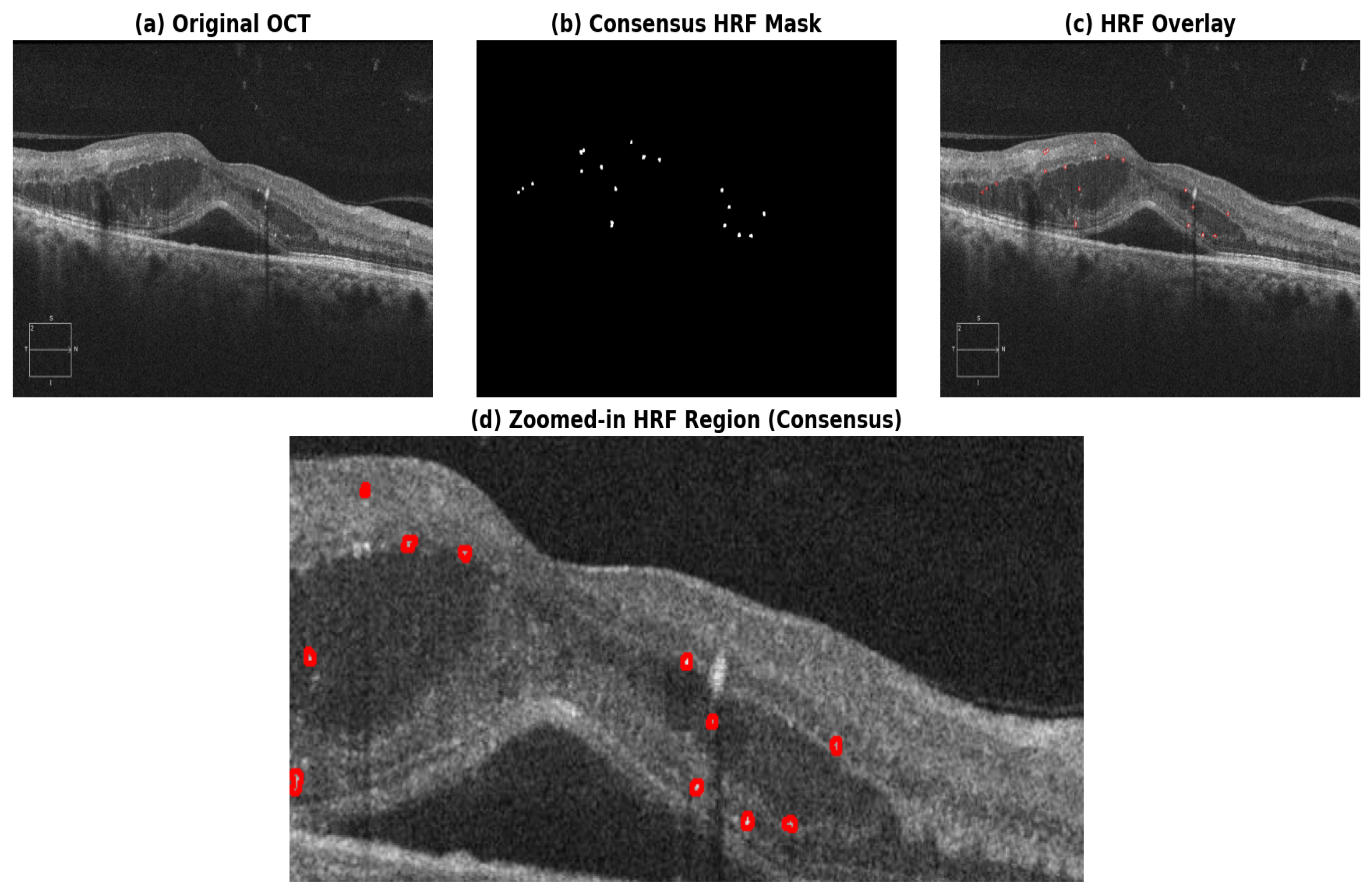 U-Net Optimization for Hyperreflective Foci Segmentation in Retinal OCT