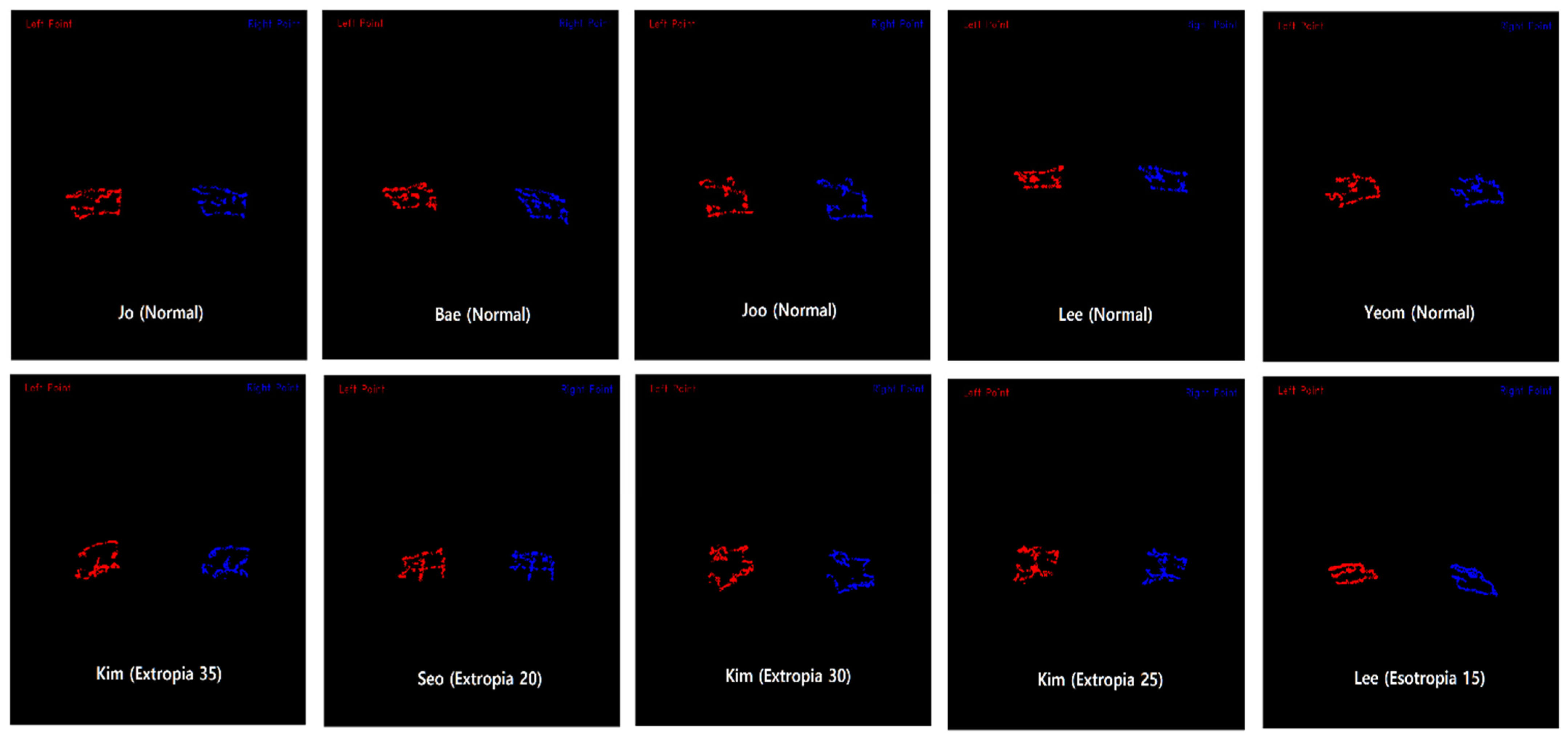 AI-Assisted Strabismus Diagnosis Using Eye-Tracking and Machine Learning