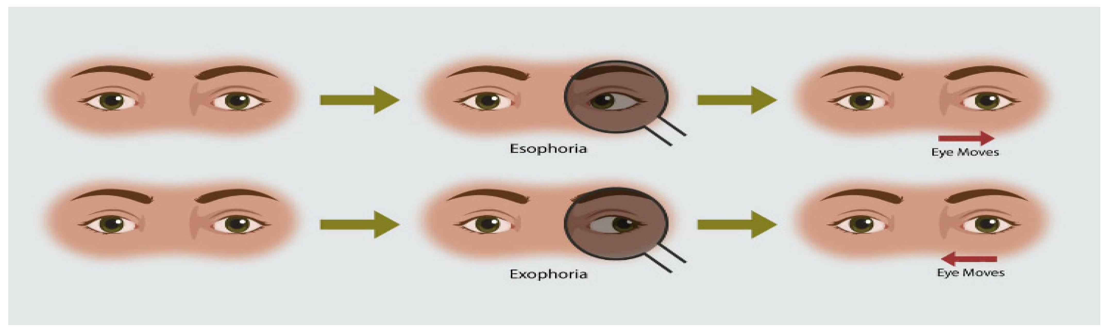 AI-Assisted Strabismus Diagnosis Using Eye-Tracking and Machine Learning