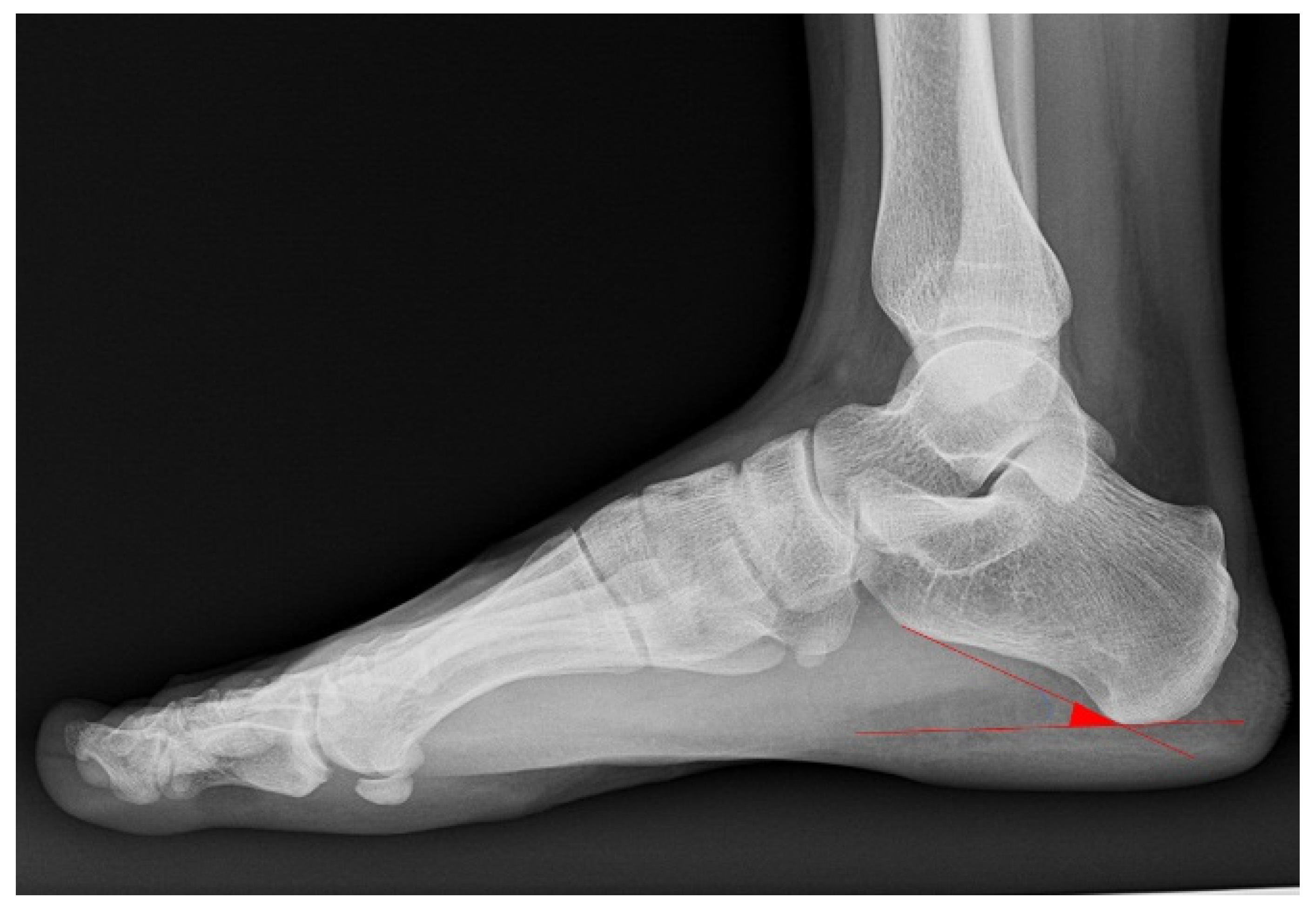 Association Between Calcaneal Inclination Angle and Spinal and Lower ...
