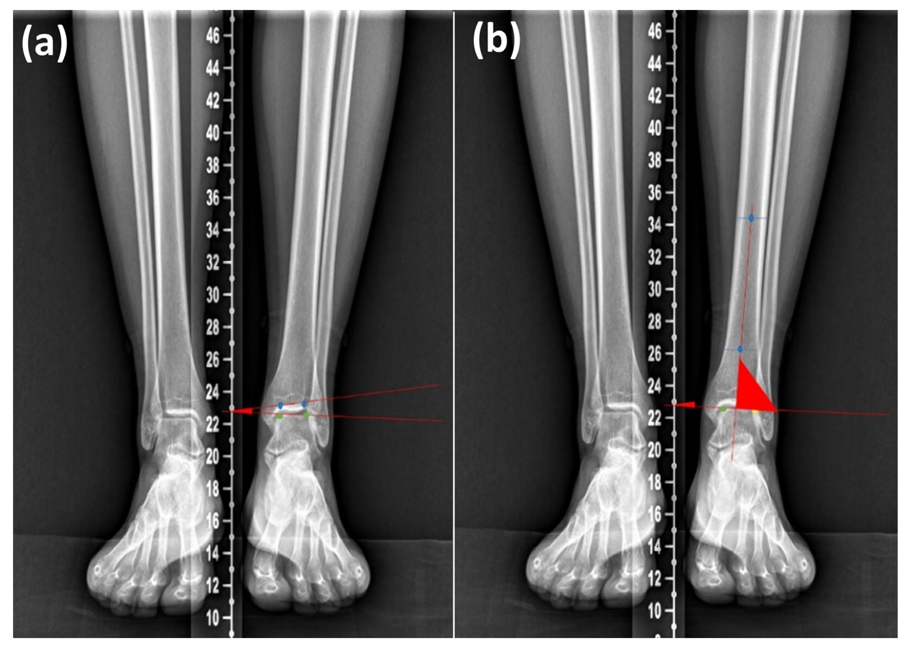 Association Between Calcaneal Inclination Angle and Spinal and Lower ...