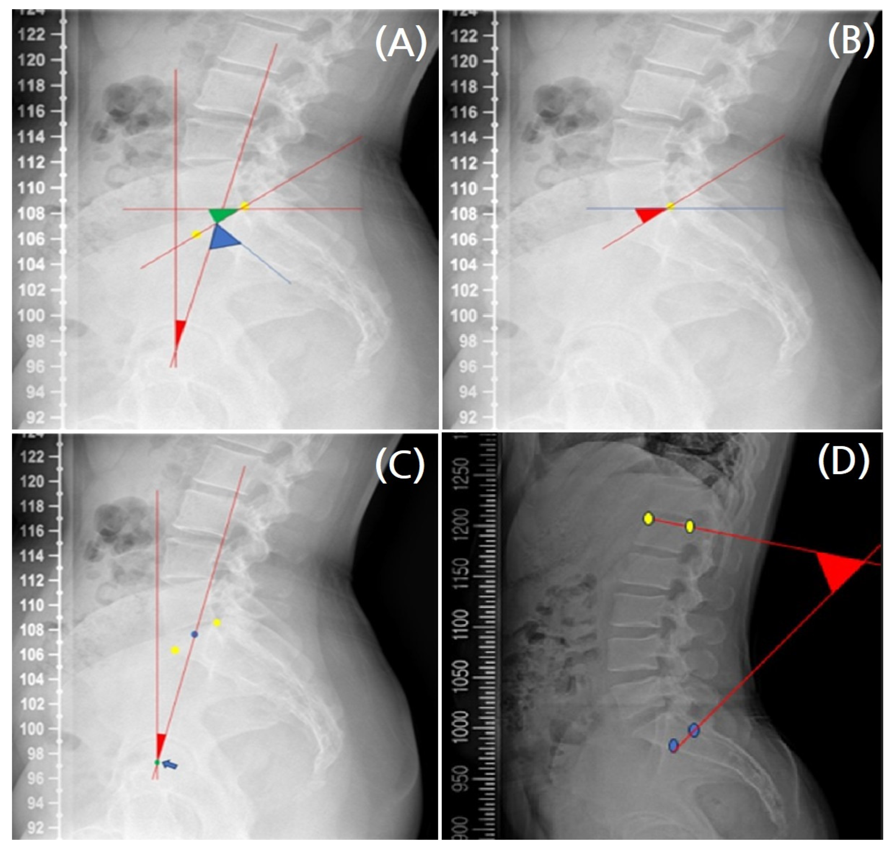 Association Between Calcaneal Inclination Angle and Spinal and Lower ...