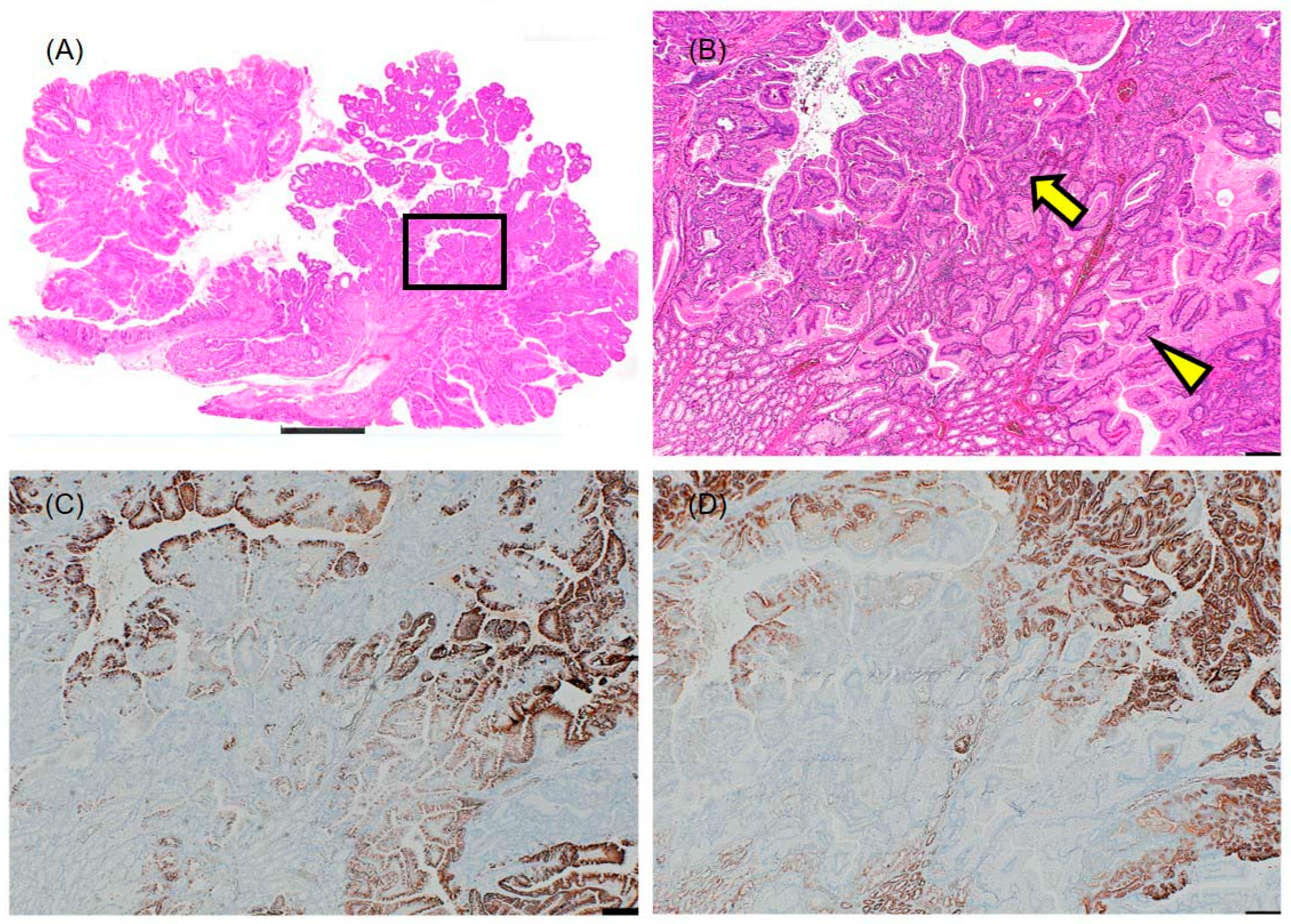 Gastric-Type Mixed Neoplastic and Non-Neoplastic Lesions in the ...