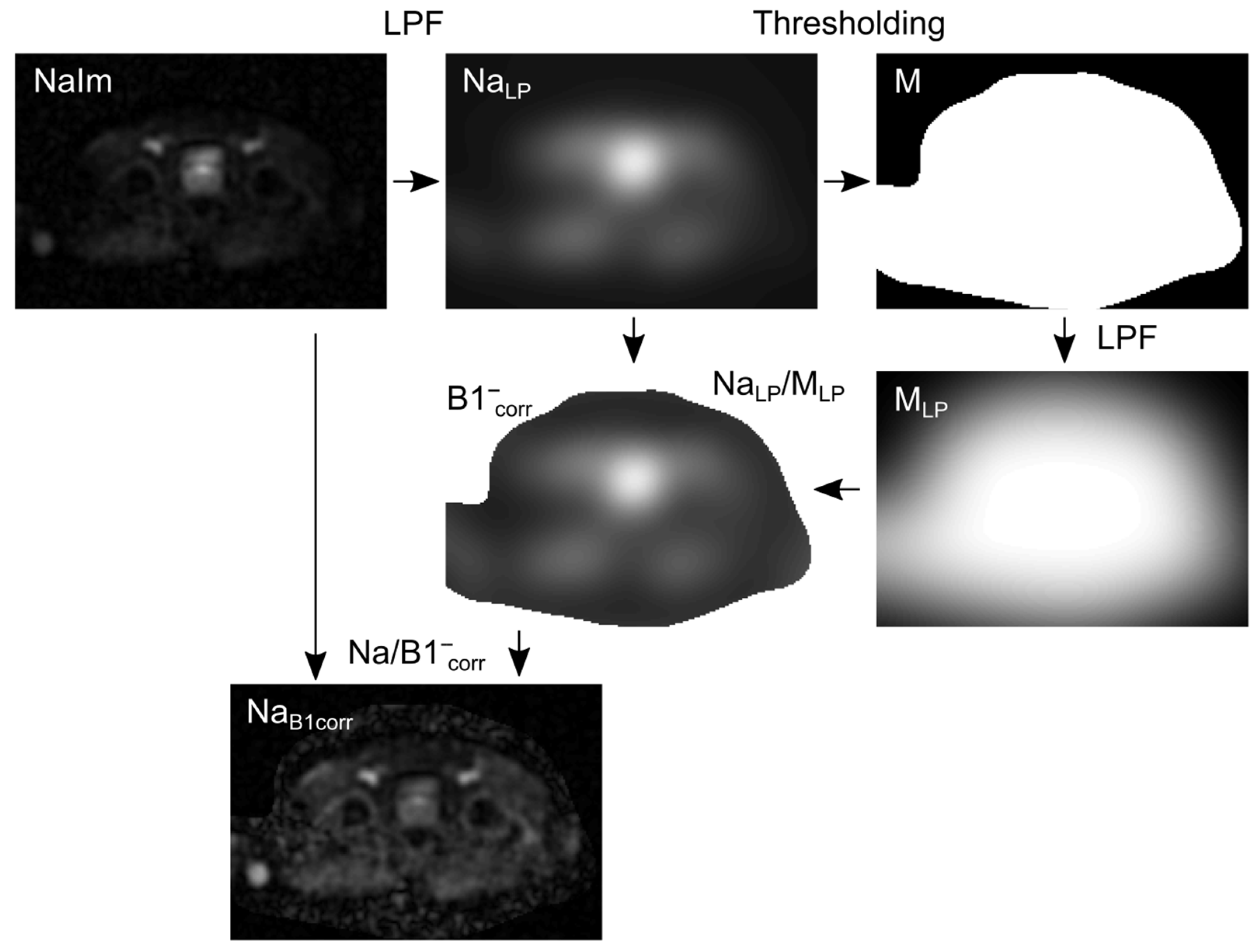 Decreased Tissue Sodium Concentration in Suspected Prostate Cancer ...