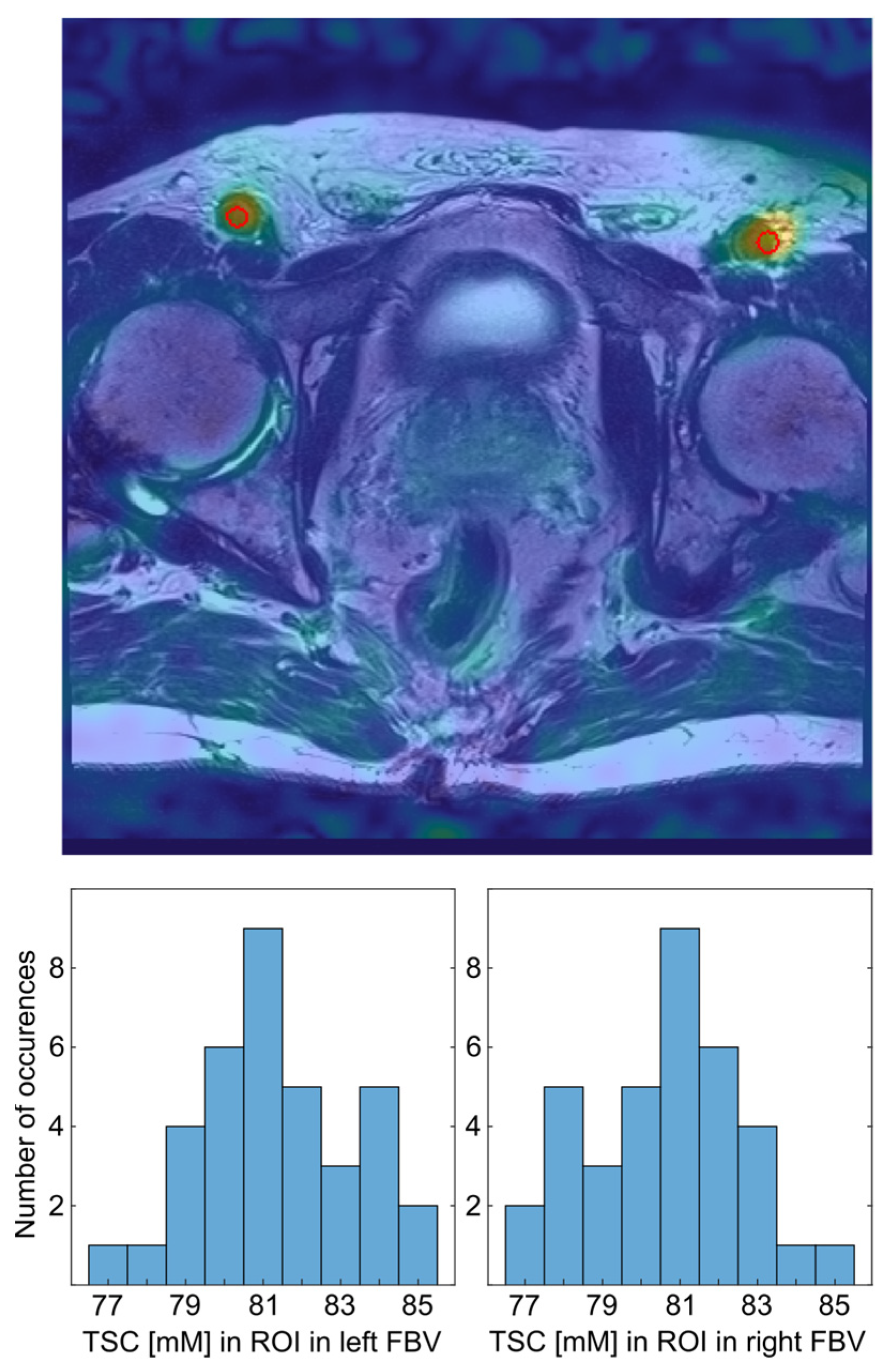 Decreased Tissue Sodium Concentration in Suspected Prostate Cancer ...