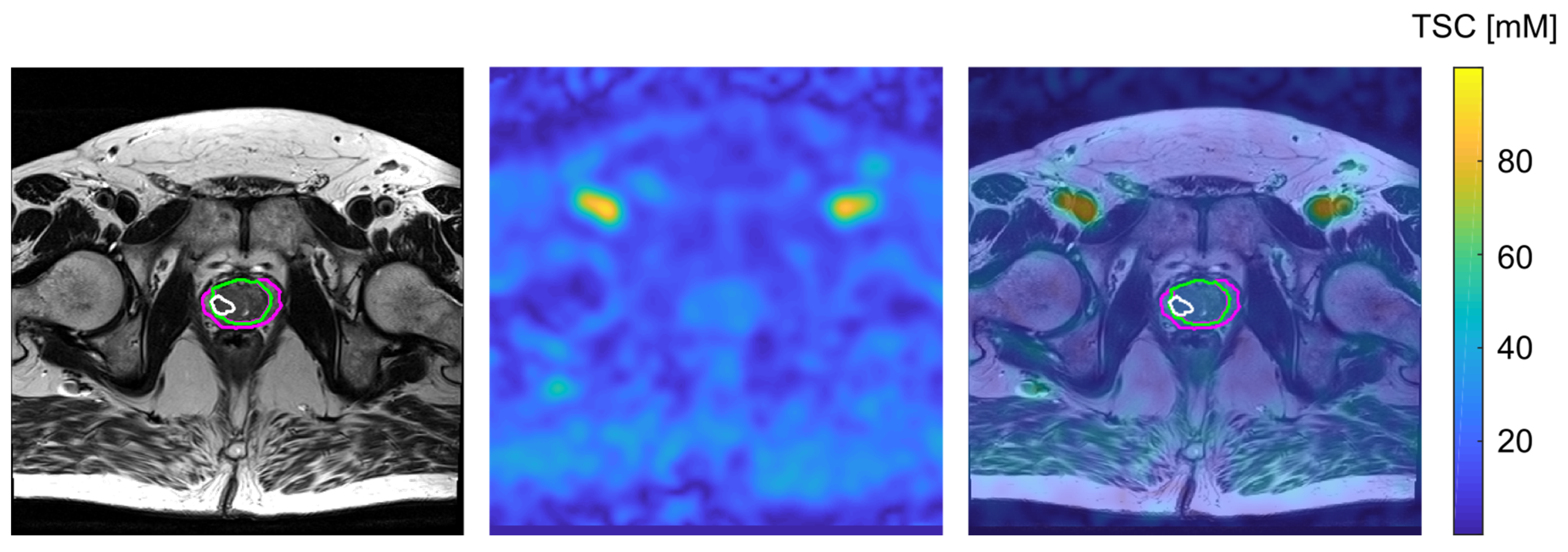 Decreased Tissue Sodium Concentration in Suspected Prostate Cancer ...