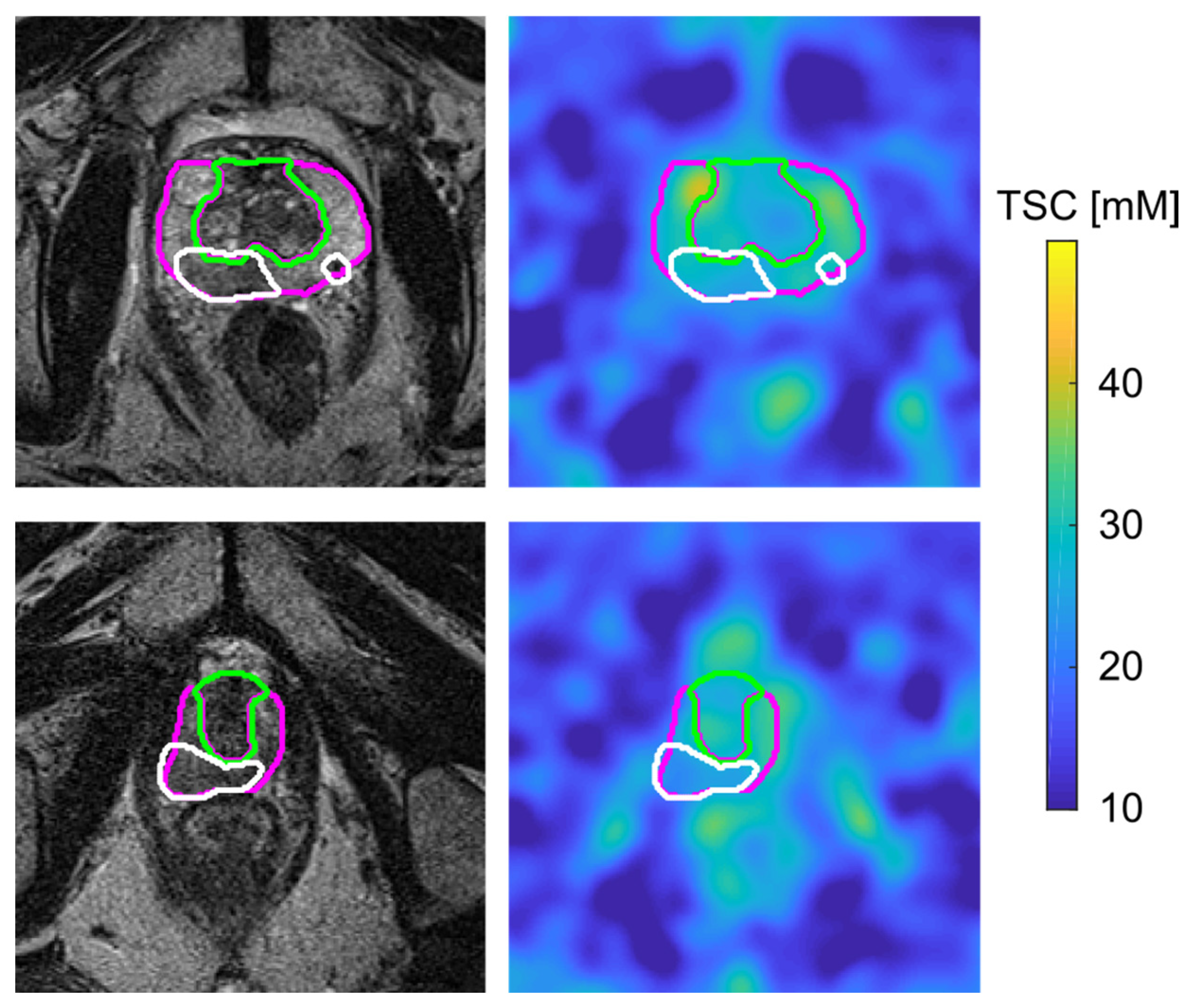 Decreased Tissue Sodium Concentration in Suspected Prostate Cancer ...