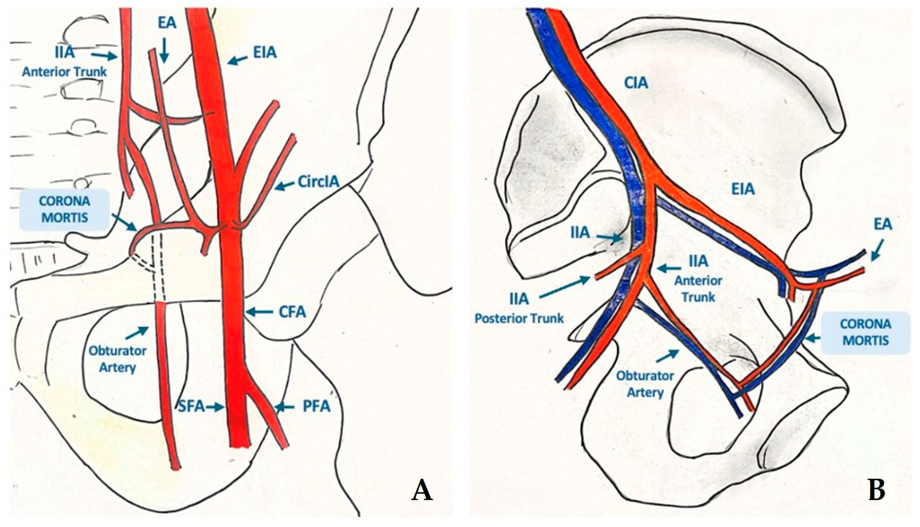 “The Road Less Traveled”: Endovascular Embolization of a Type II ...