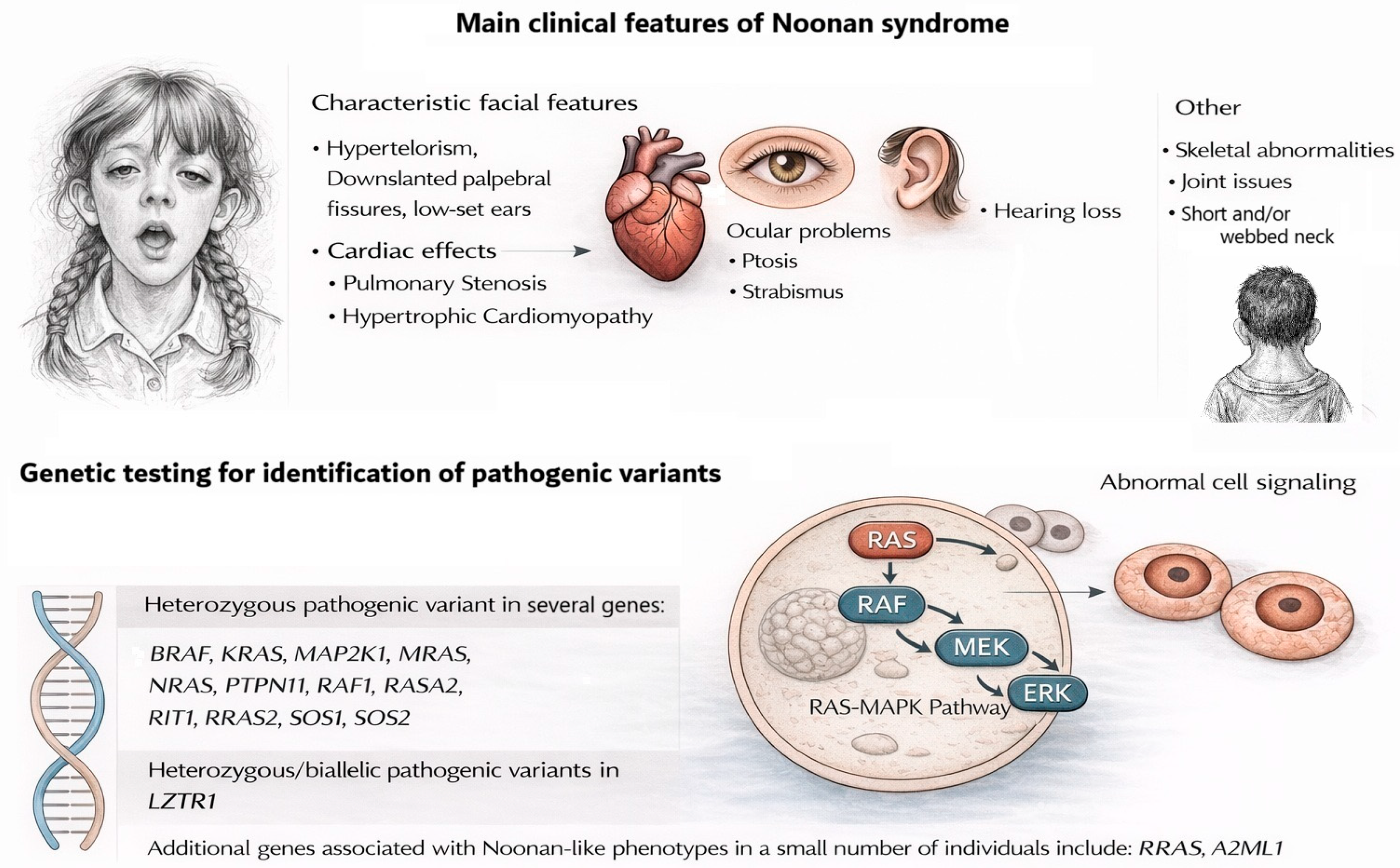 Molecular Diagnosis and Phenotypic Variability of Noonan Syndrome ...