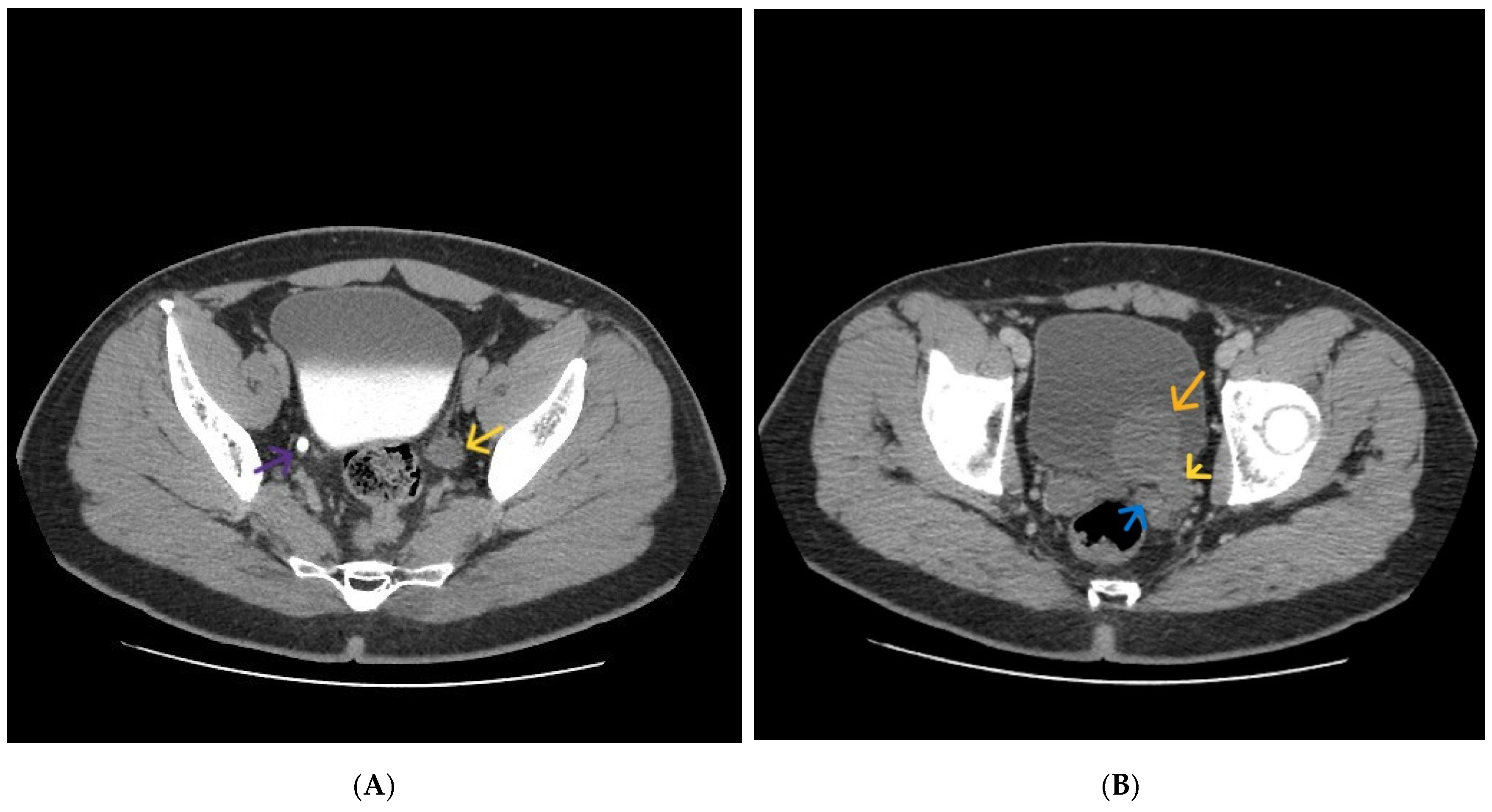 Zinner Syndrome: A Narrative Review of Imaging Findings with an ...