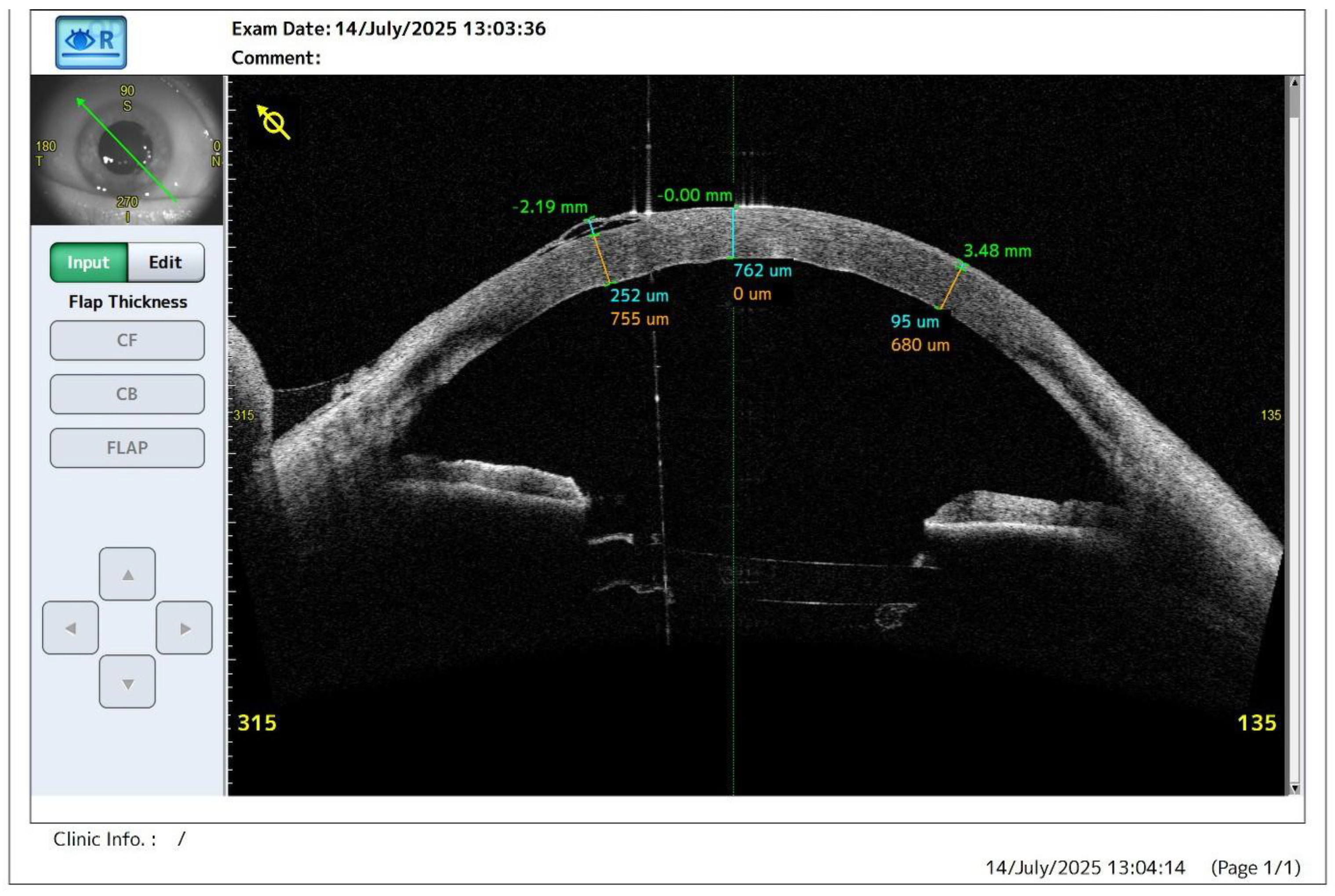 Multiplanar AS-OCT Detection of Clinically Occult Posterior Gas Bubble ...