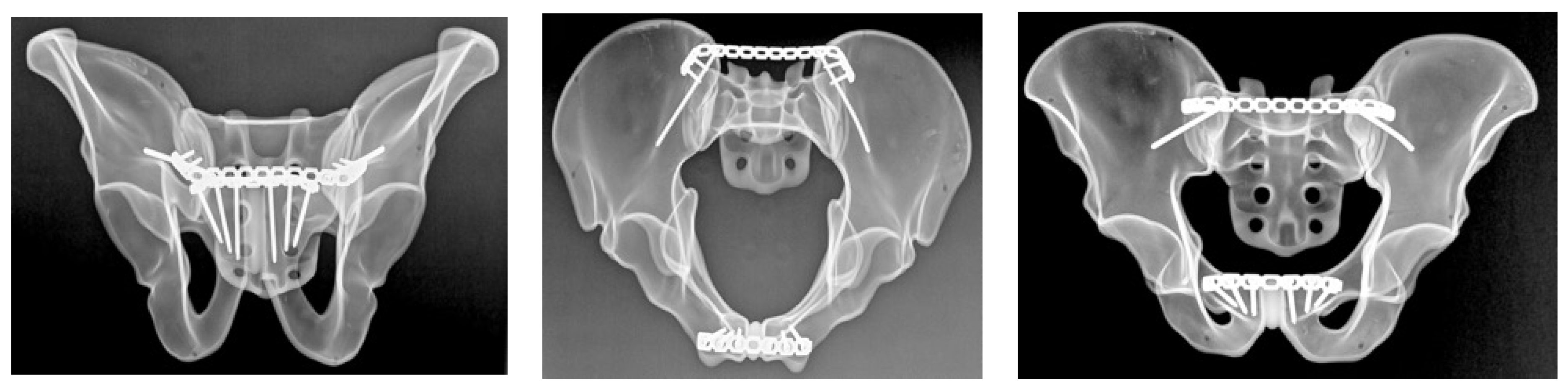 Exploratory Biomechanical Comparison of Three Posterior Pelvic Ring ...
