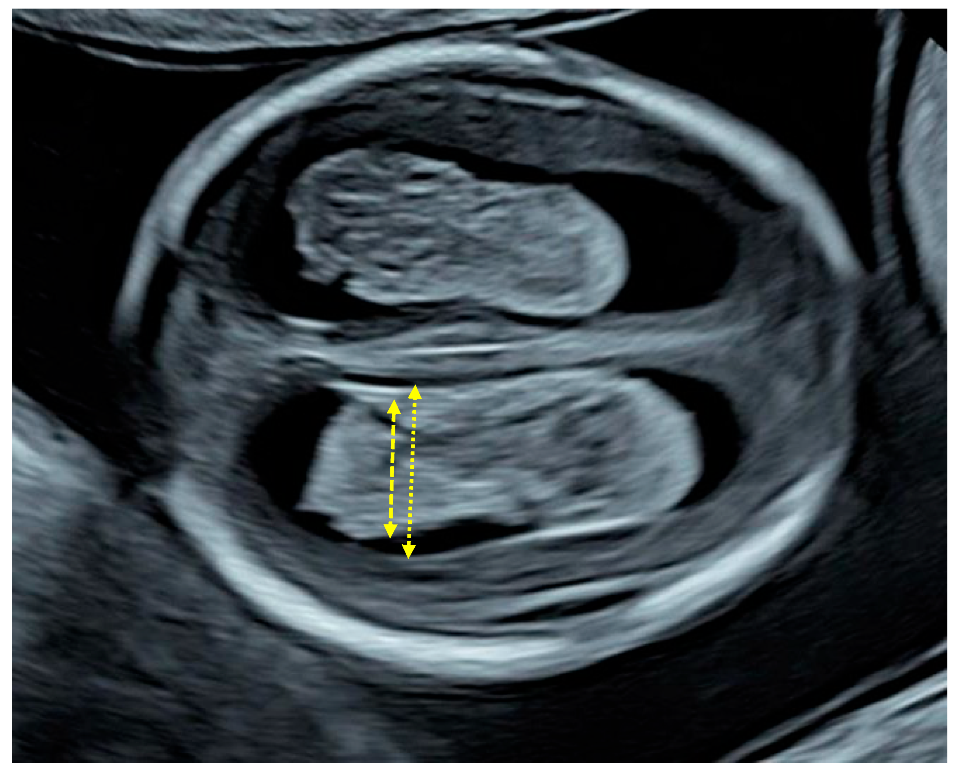 Dangling Choroid Plexus: An Early Sign of Fetal Anomaly