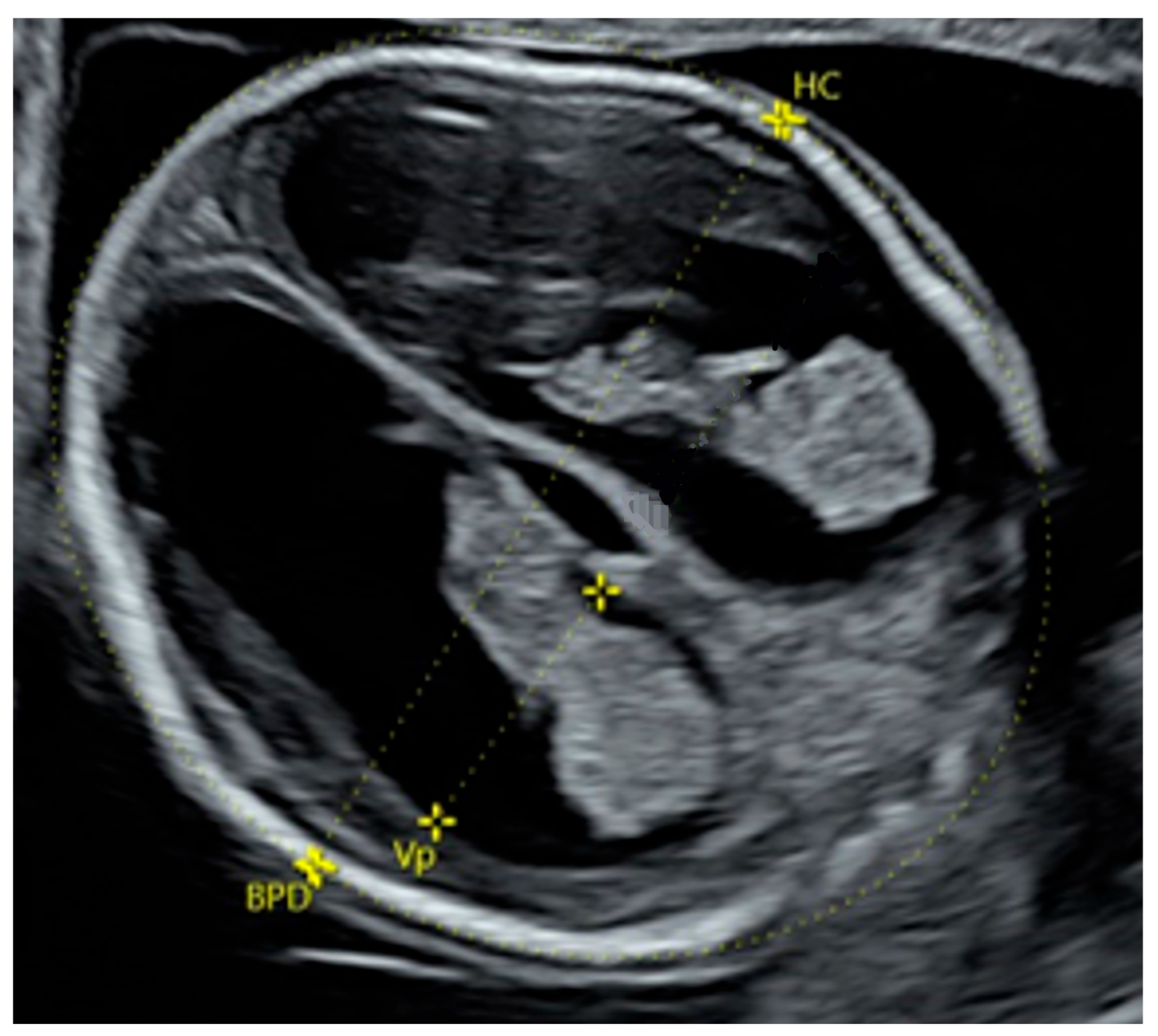 Dangling Choroid Plexus: An Early Sign of Fetal Anomaly