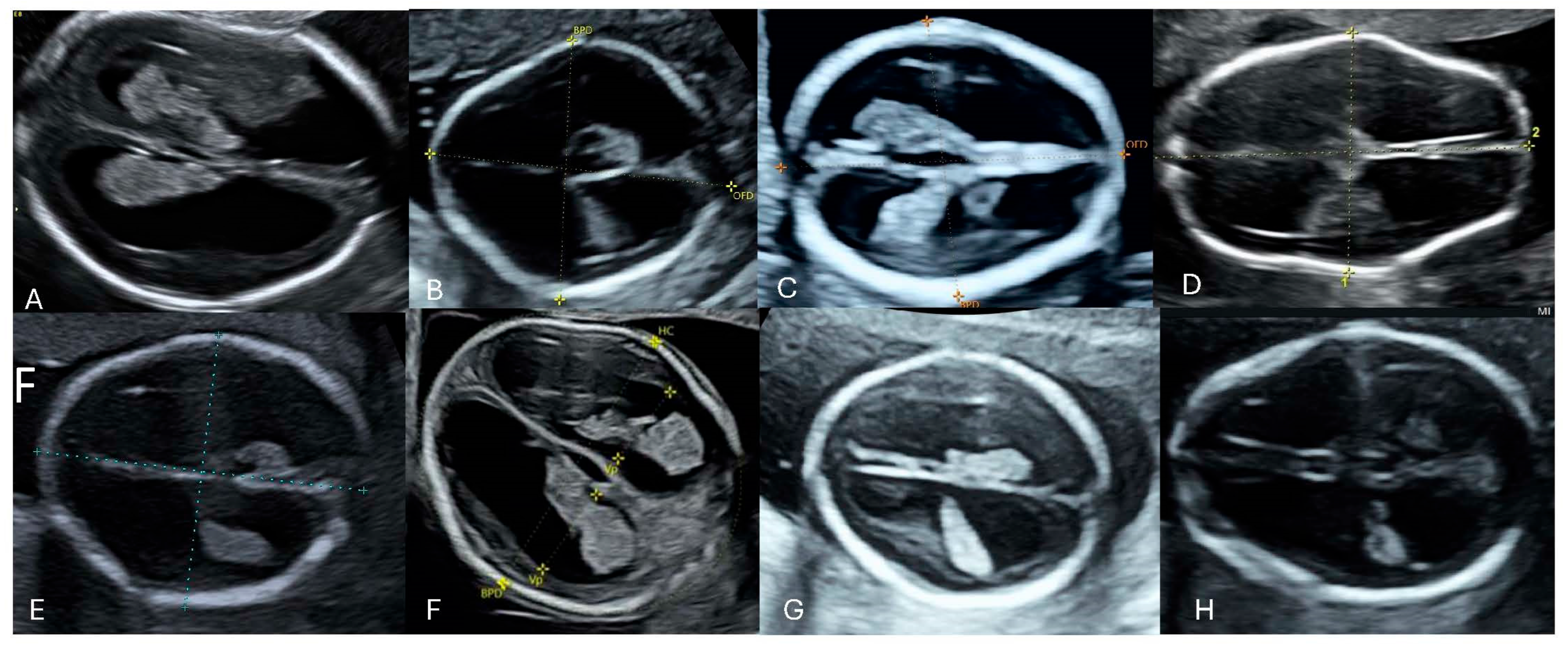 Dangling Choroid Plexus: An Early Sign of Fetal Anomaly