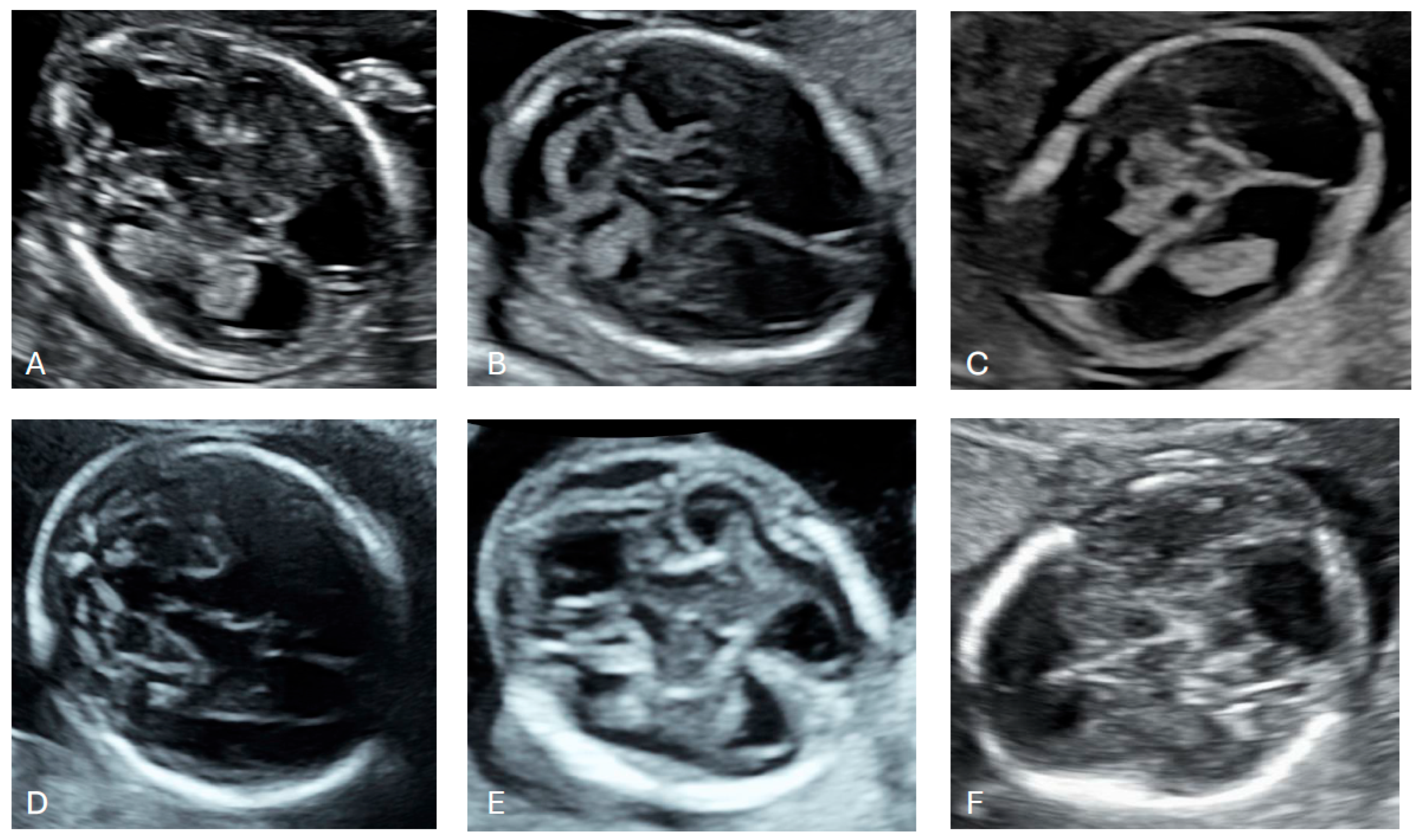 Dangling Choroid Plexus: An Early Sign of Fetal Anomaly