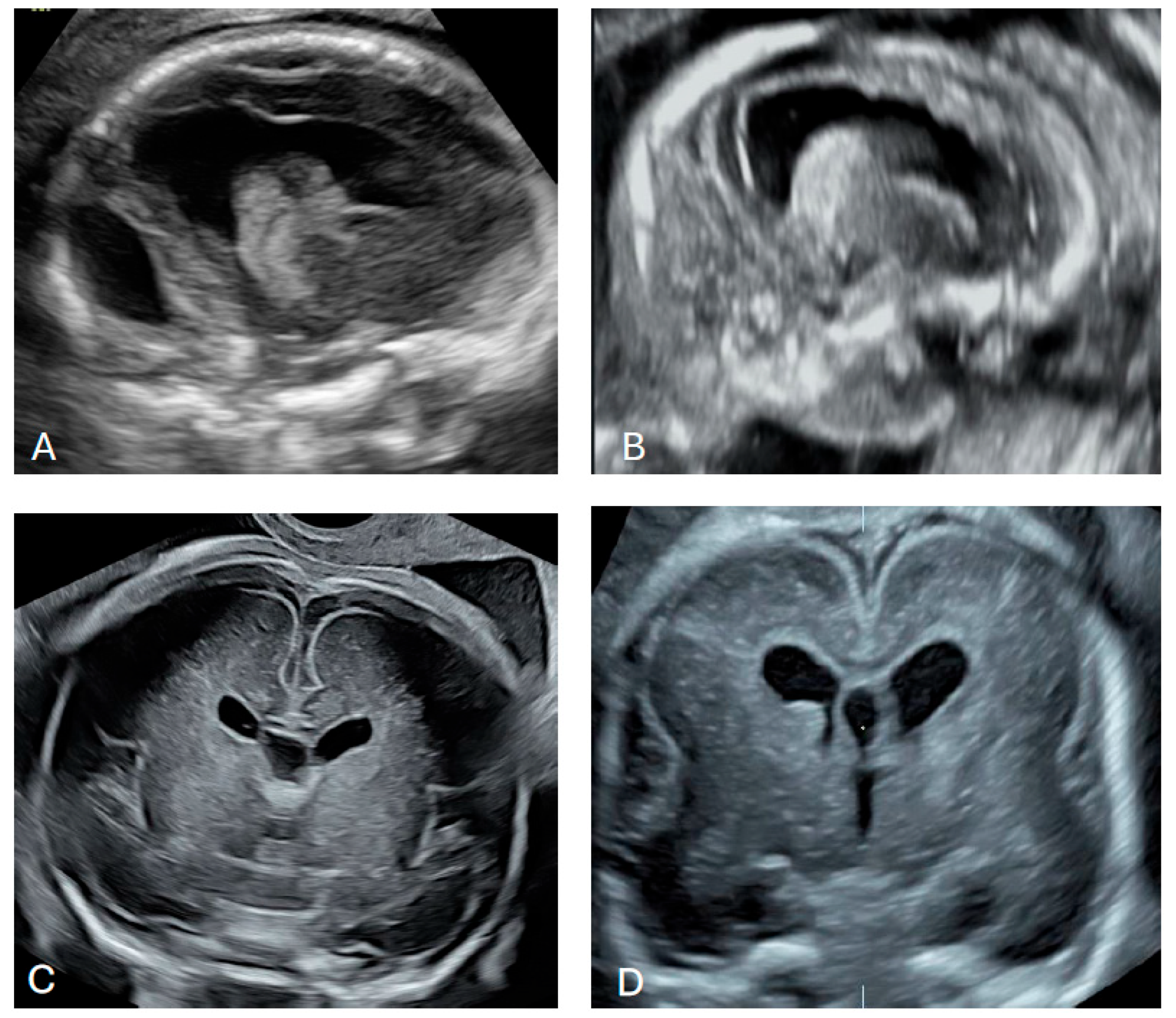 Dangling Choroid Plexus: An Early Sign of Fetal Anomaly