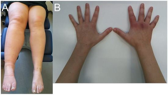 Edema as a Key Presentation of Acrodermatitis Chronica Atrophicans: A ...