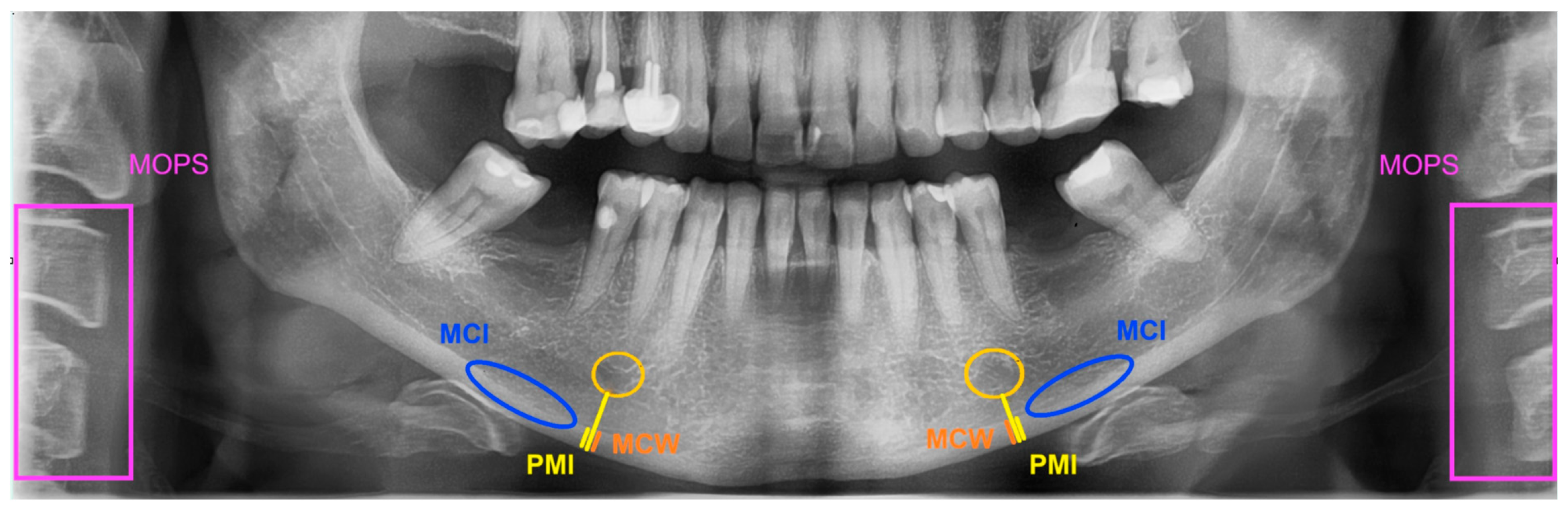 Osteoporosis Diagnostics in Dental Radiology (Panoramic Radiograph ...