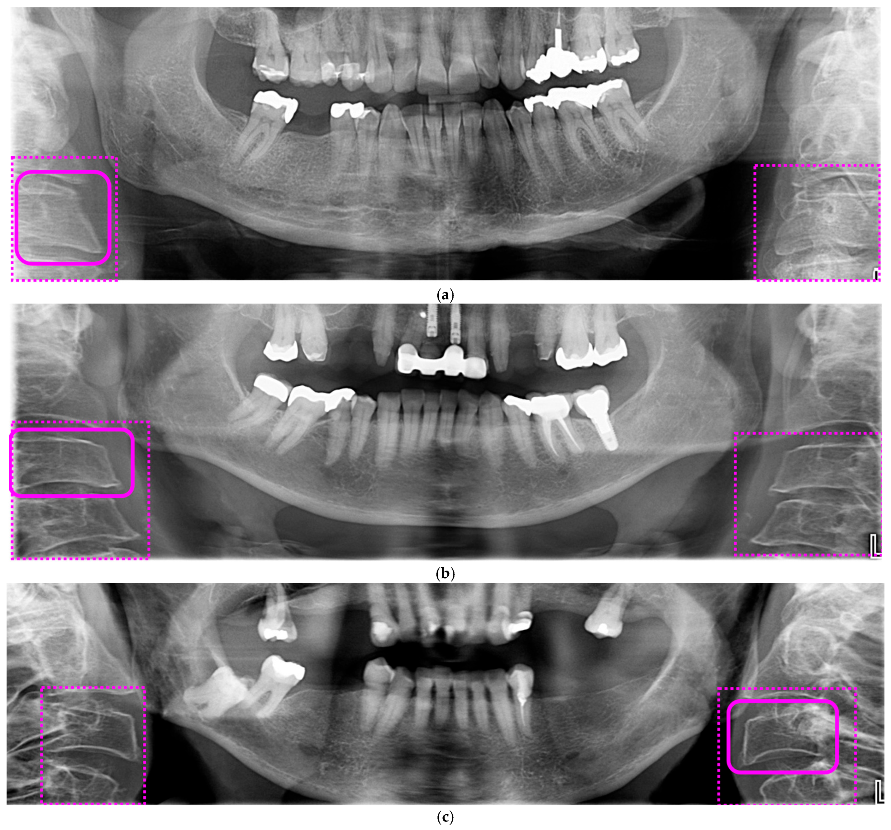 Osteoporosis Diagnostics in Dental Radiology (Panoramic Radiograph ...