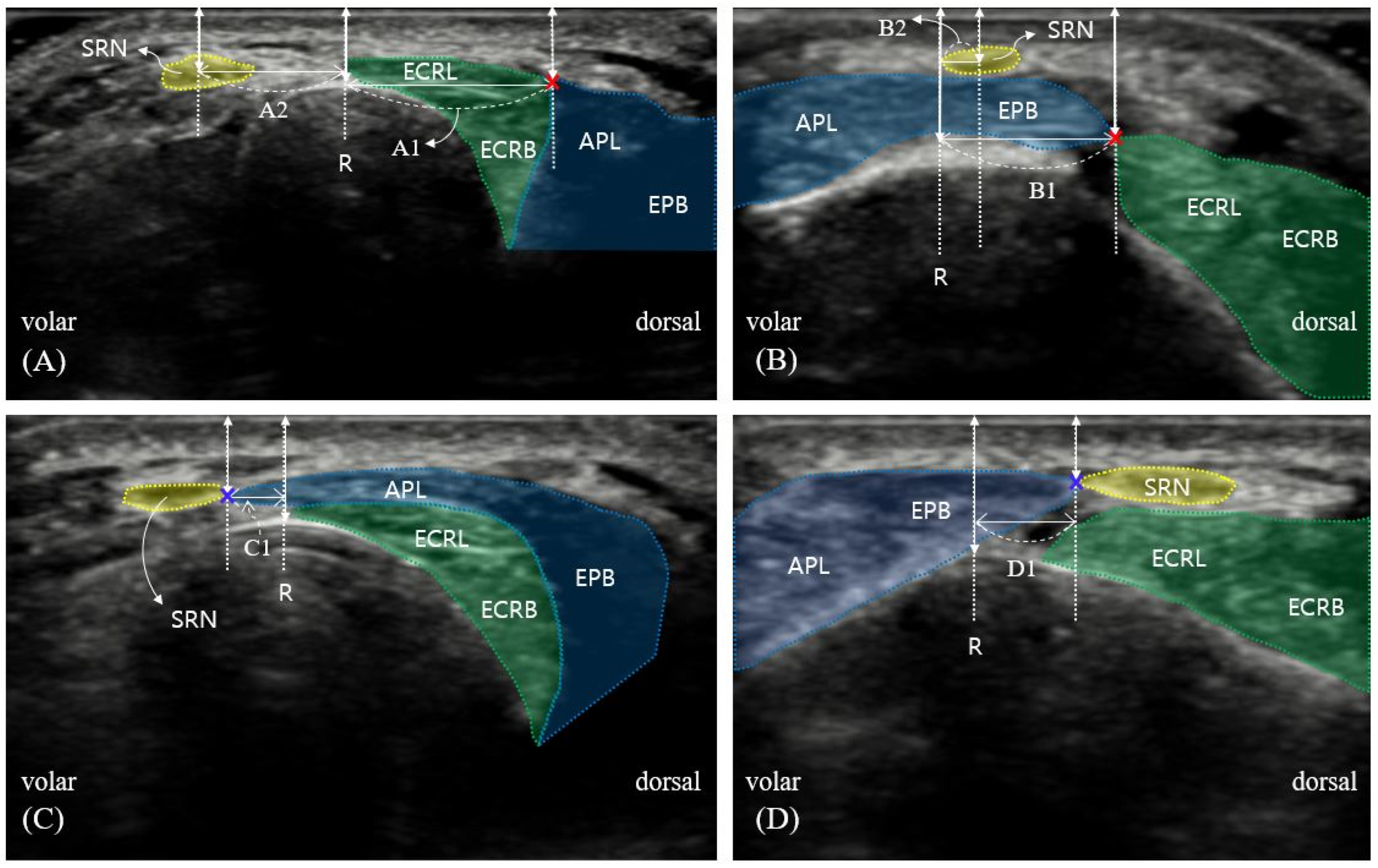An Ultrasonographic Study of the Superficial Radial Nerve in Healthy ...