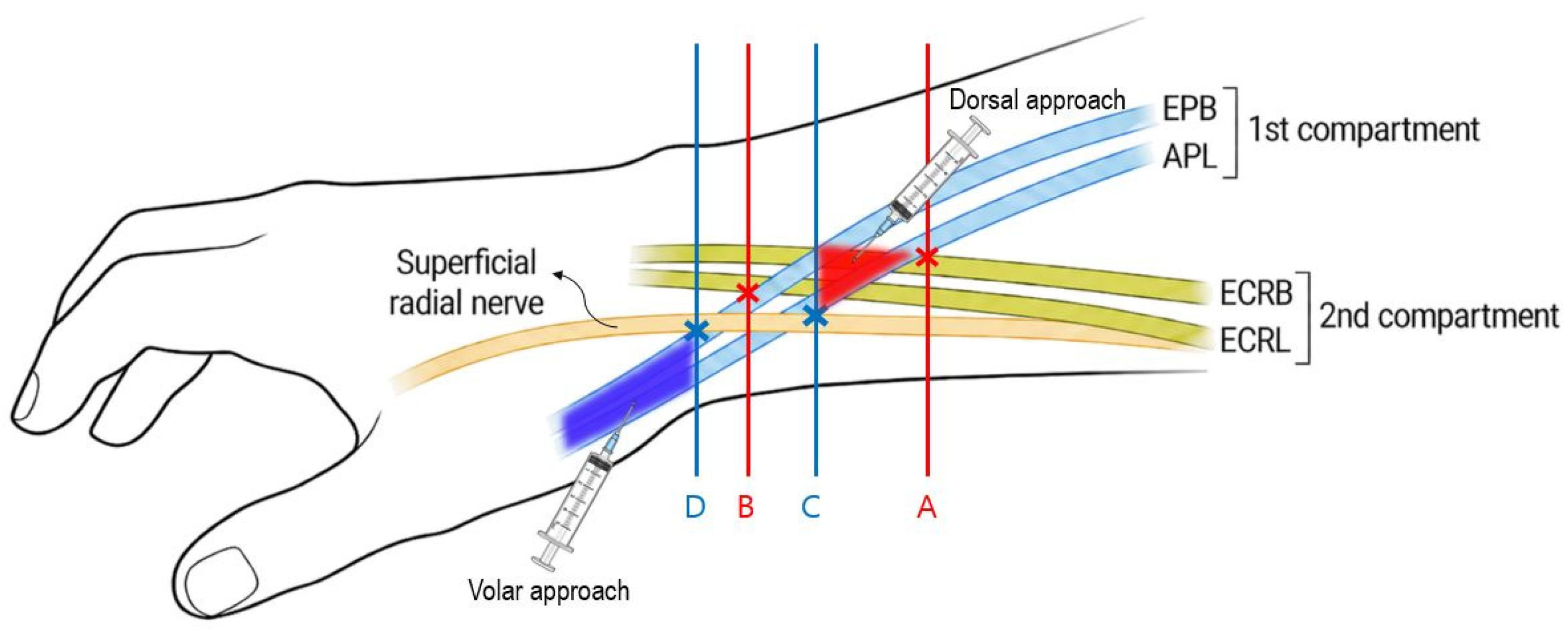 An Ultrasonographic Study of the Superficial Radial Nerve in Healthy ...