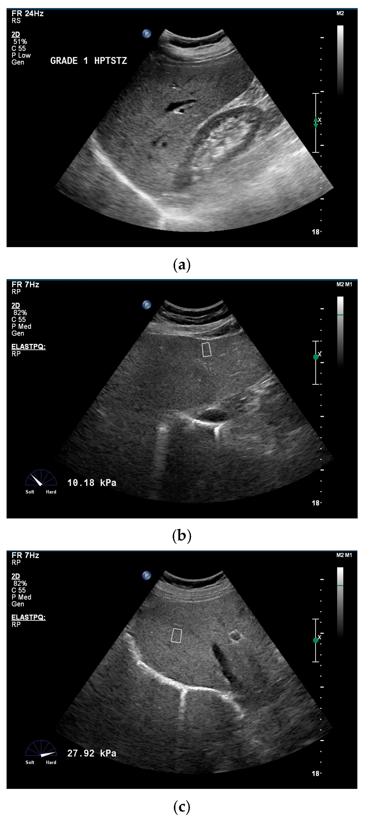 Does Hepatosteatosis Affect Shear-Wave Elastography Values in Chronic ...