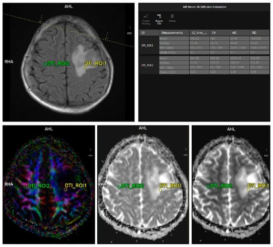 Perilesional Diffusion Tensor Imaging for Differentiating Malignant and ...