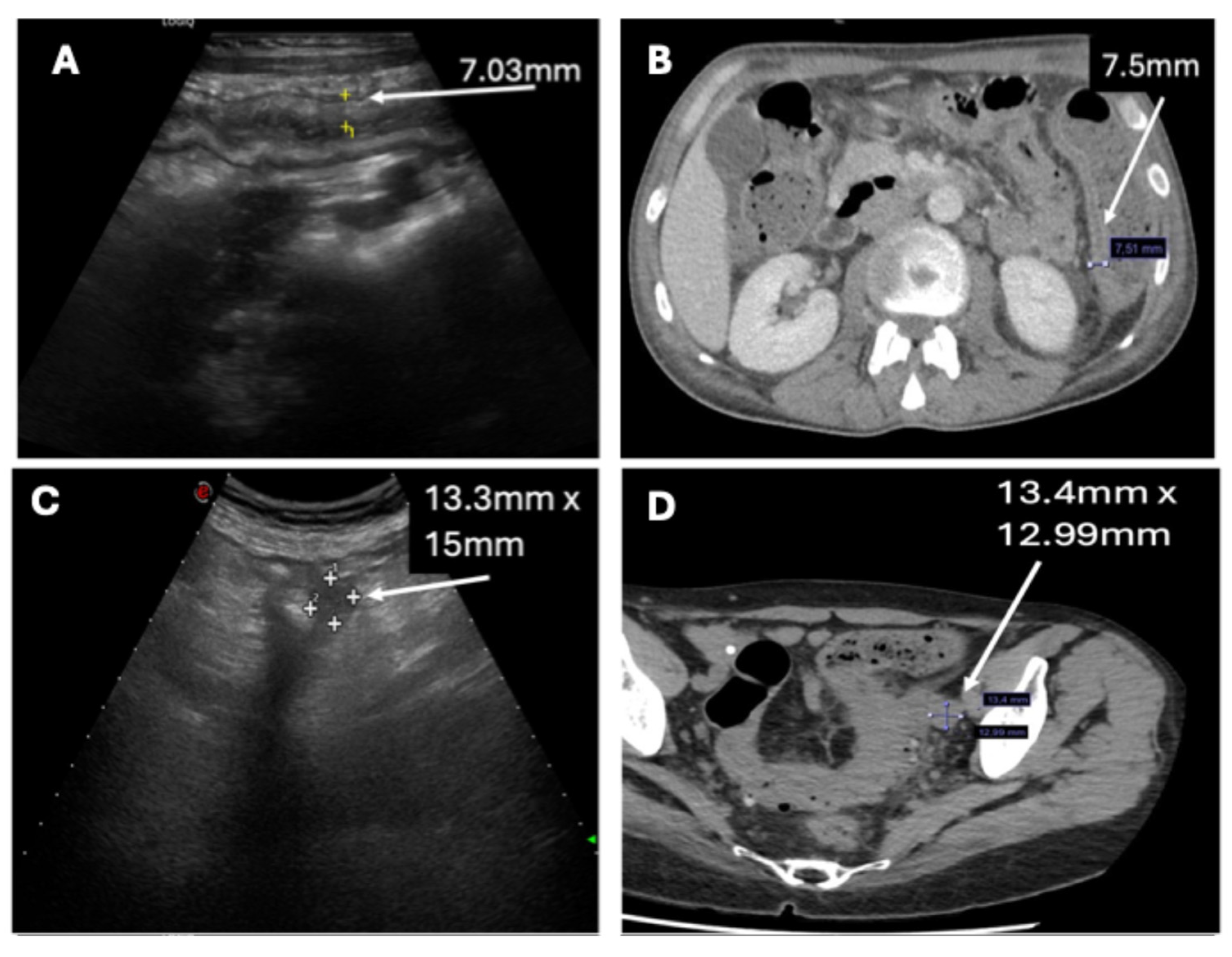 Bedside Ultrasound Versus Computed Tomography in Adult Neutropenic ...