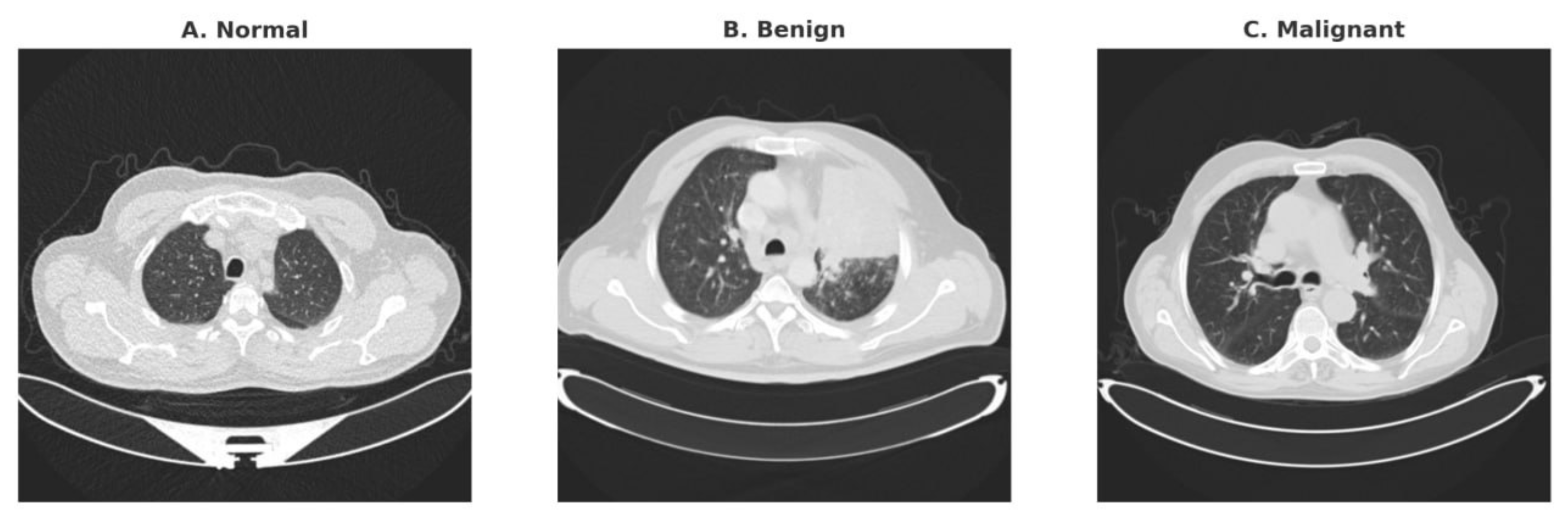 Segmentation-Guided Hybrid Deep Learning for Pulmonary Nodule Detection ...