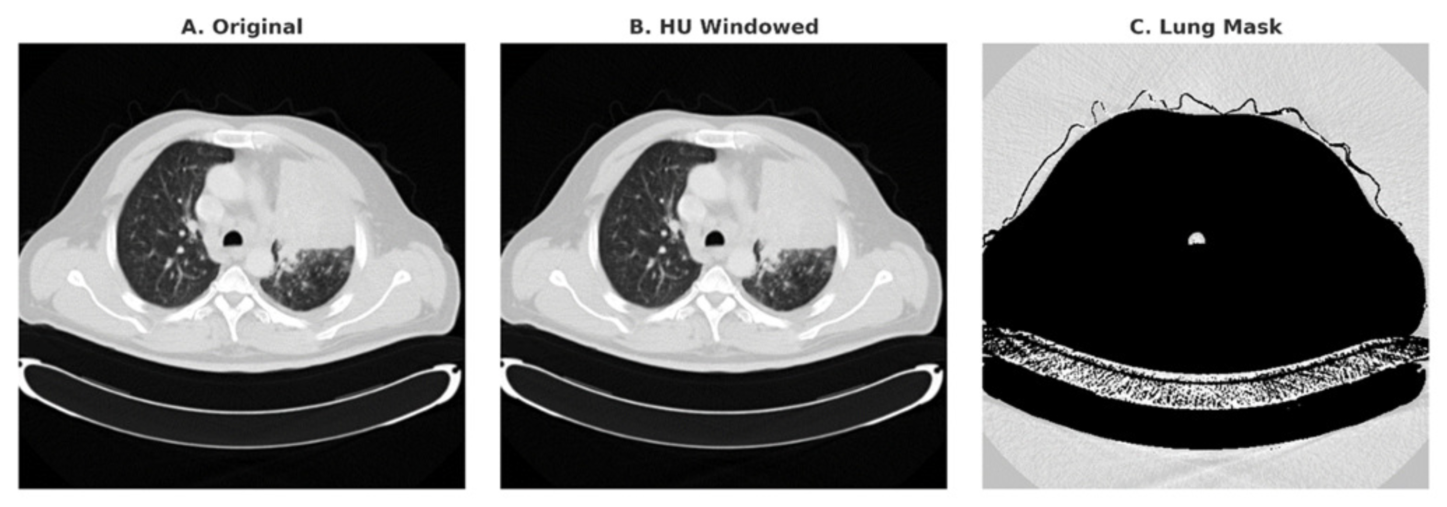 Segmentation-Guided Hybrid Deep Learning for Pulmonary Nodule Detection ...