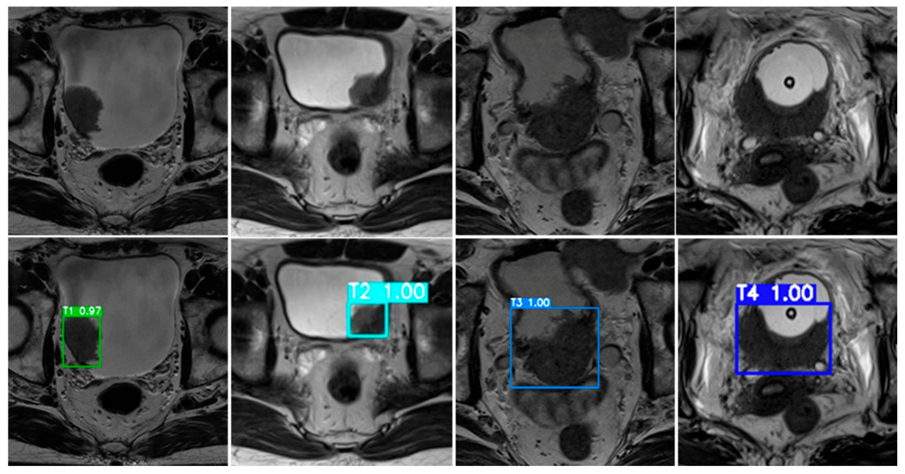MRI-Based Bladder Cancer Staging via YOLOv11 Segmentation and Deep ...