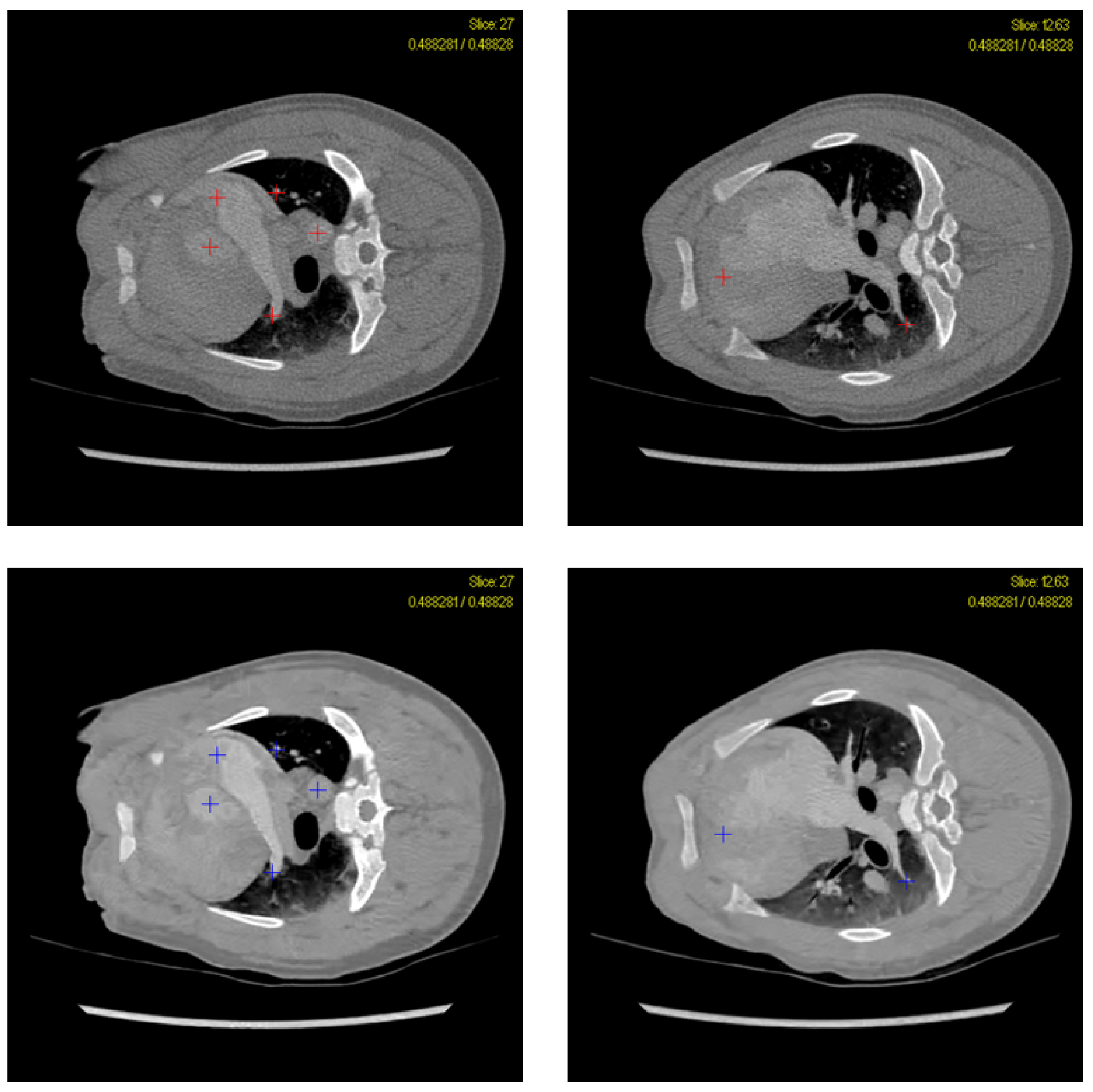 Residual Motion Correction in Low-Dose Myocardial CT Perfusion Using ...