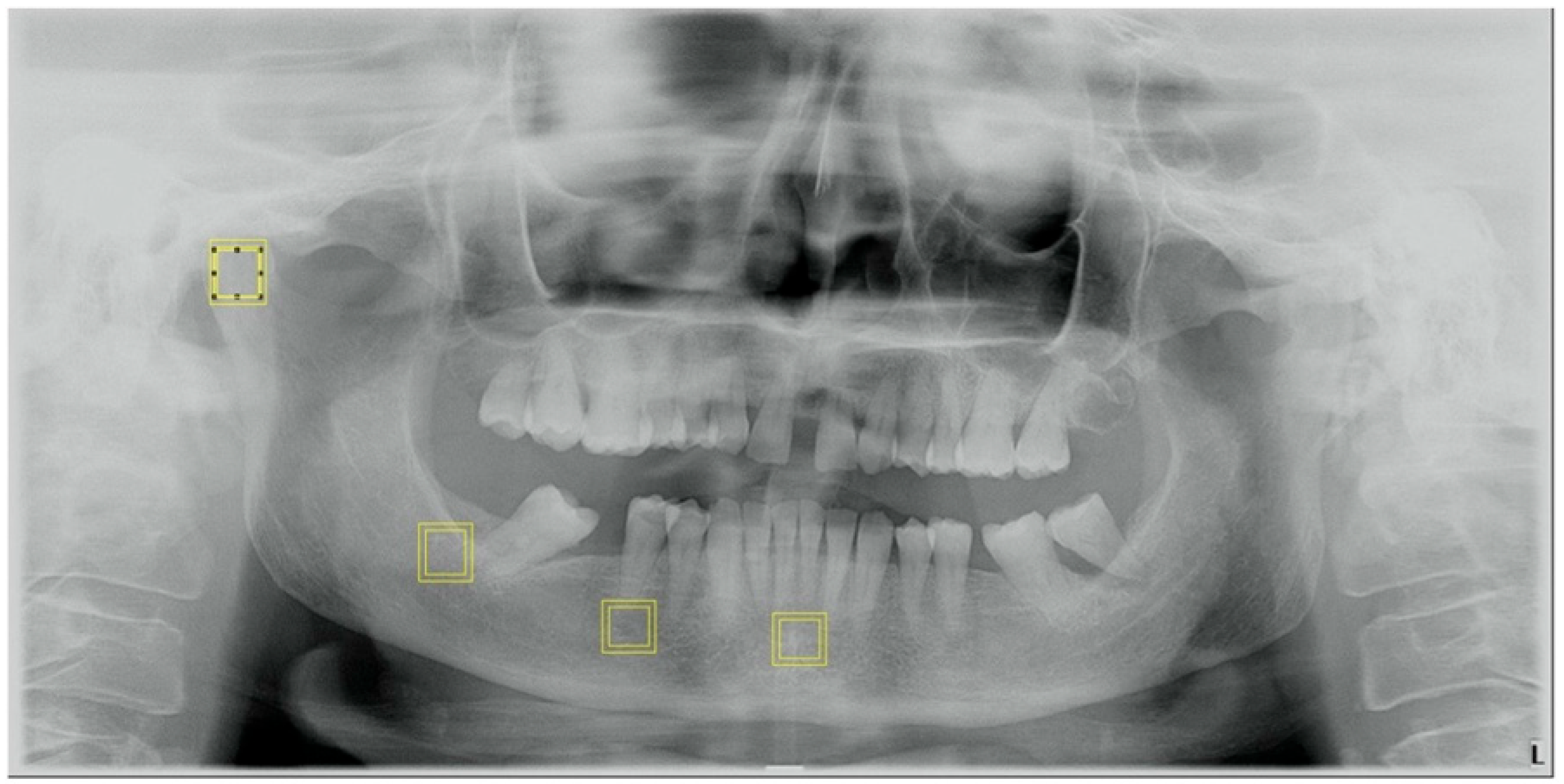 Limitations of Panoramic Radiograph-Based Fractal Dimension Analysis in ...